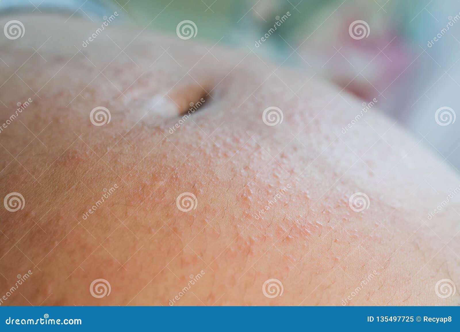 Irritated Skin during Pregnancy Stock Image - Image of rash, patient ...