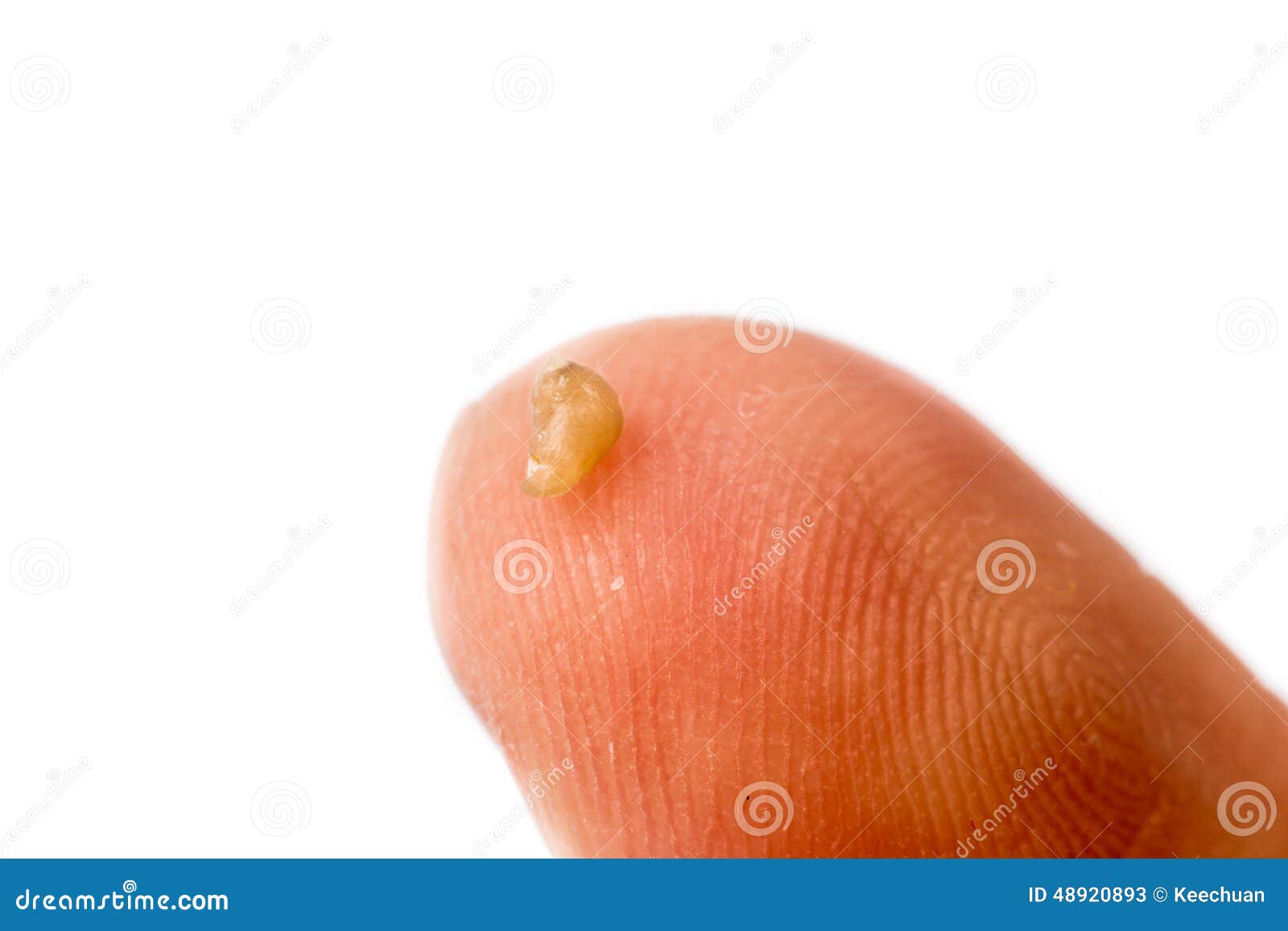Closed Up of Pimple Blackheads on a Finger Tip Stock Image - Image of ...