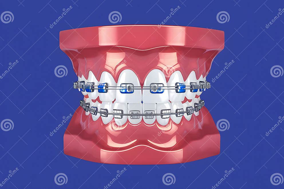 A Close Up Shot of Aligned Teeth with Blue Metallic Braces on White ...