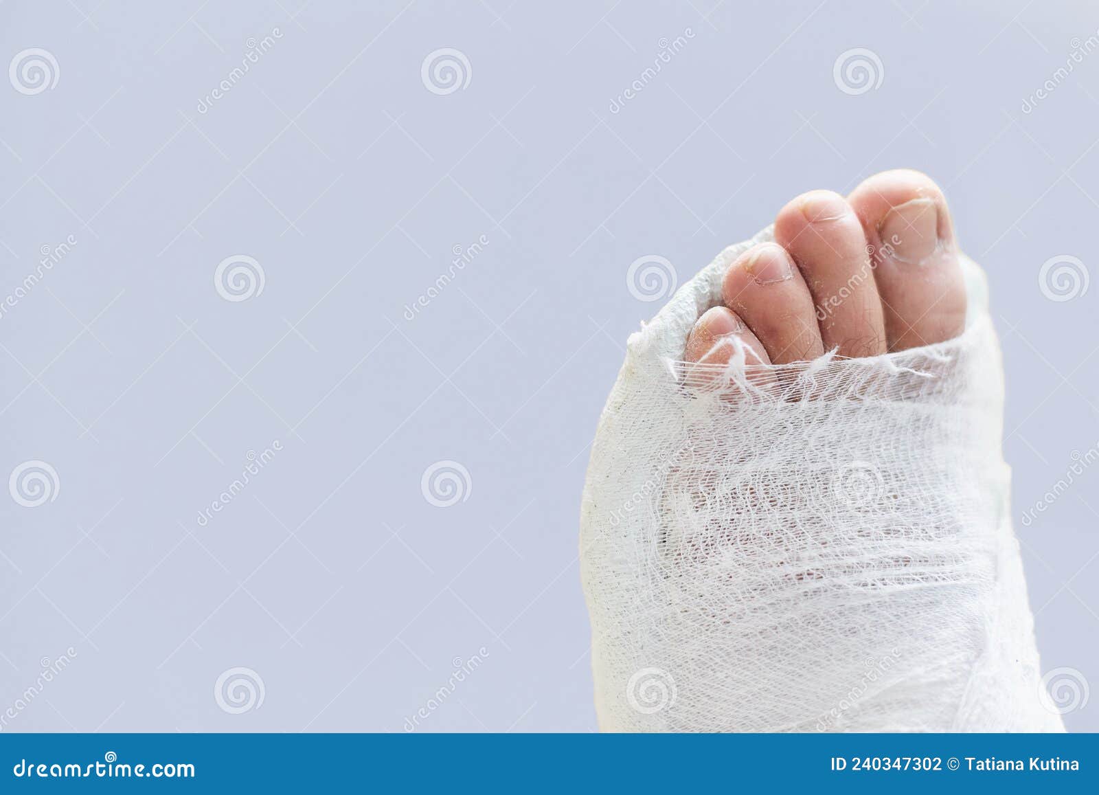Closeup of a Broken Male Foot in a Cast Stock Photo - Image of people ...