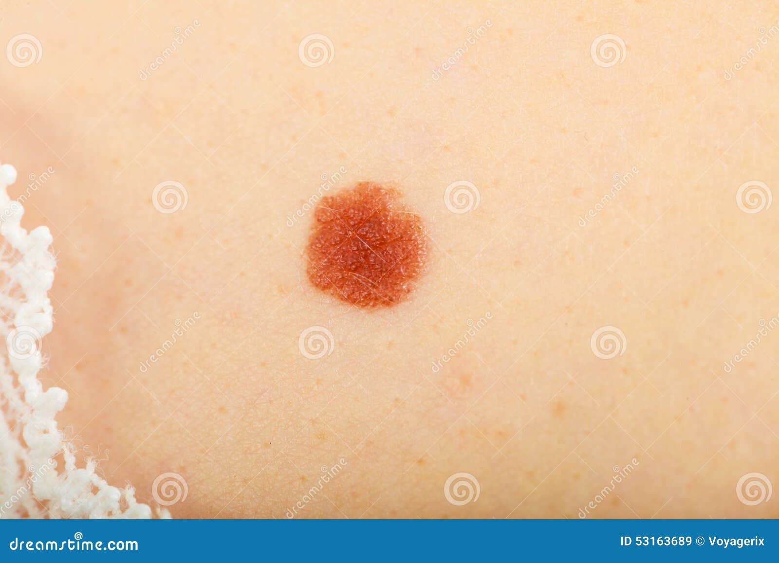 Closeup Brown Mole On Caucasian Woman Skin Stock Image Image Of