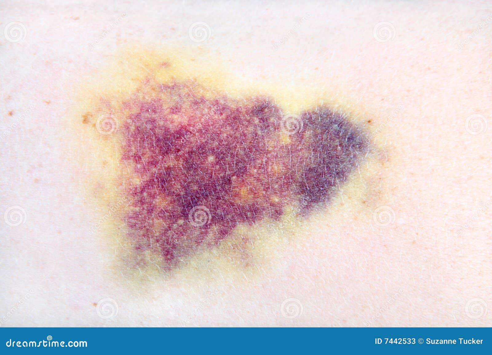 Closeup of a bruise stock image. Image of violence, contusion - 7442533