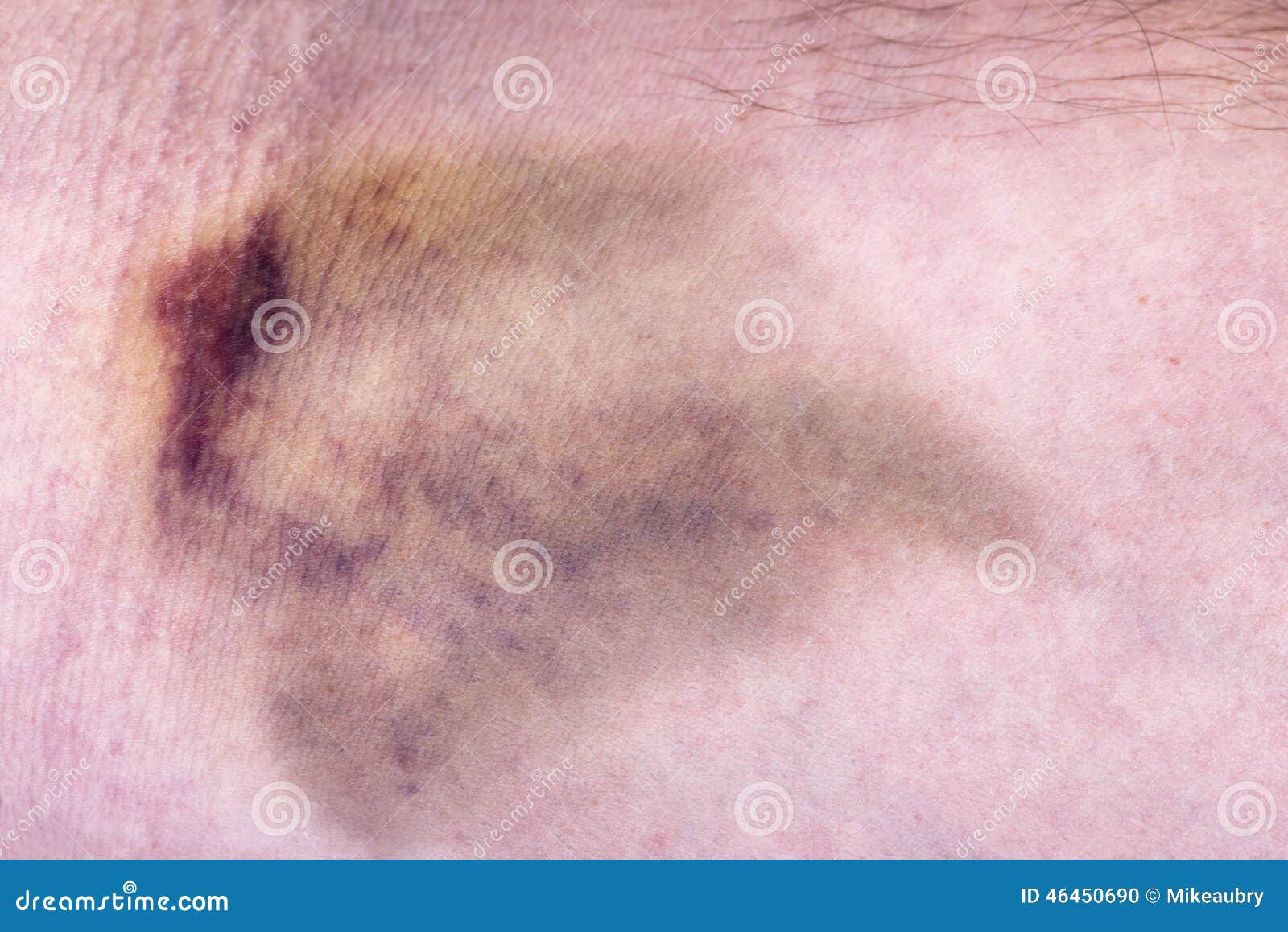 Closeup on a bruise stock photo. Image of pain, blunt - 46450690