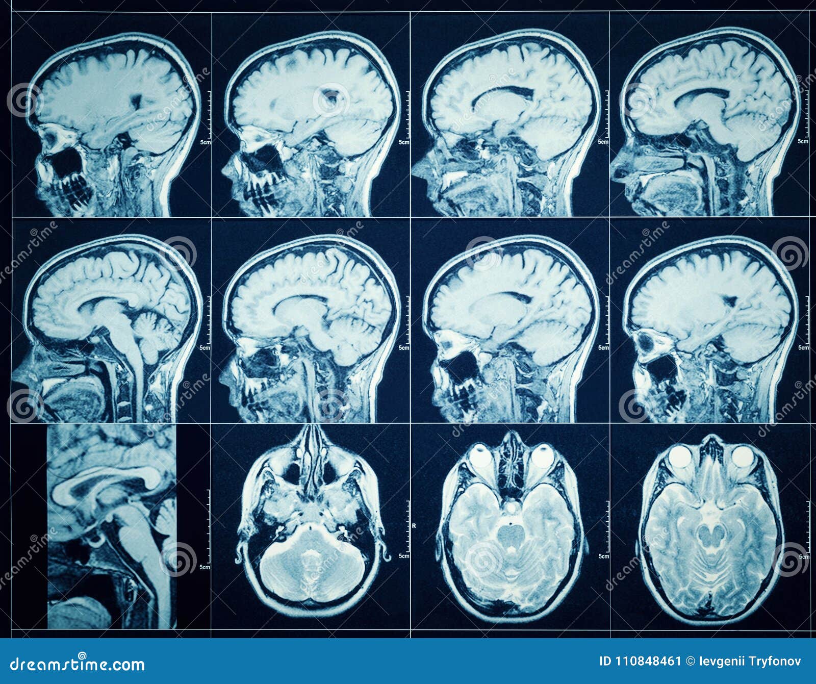 Closeup of a CT Scan with Brain Stock Image - Image of human, mind ...
