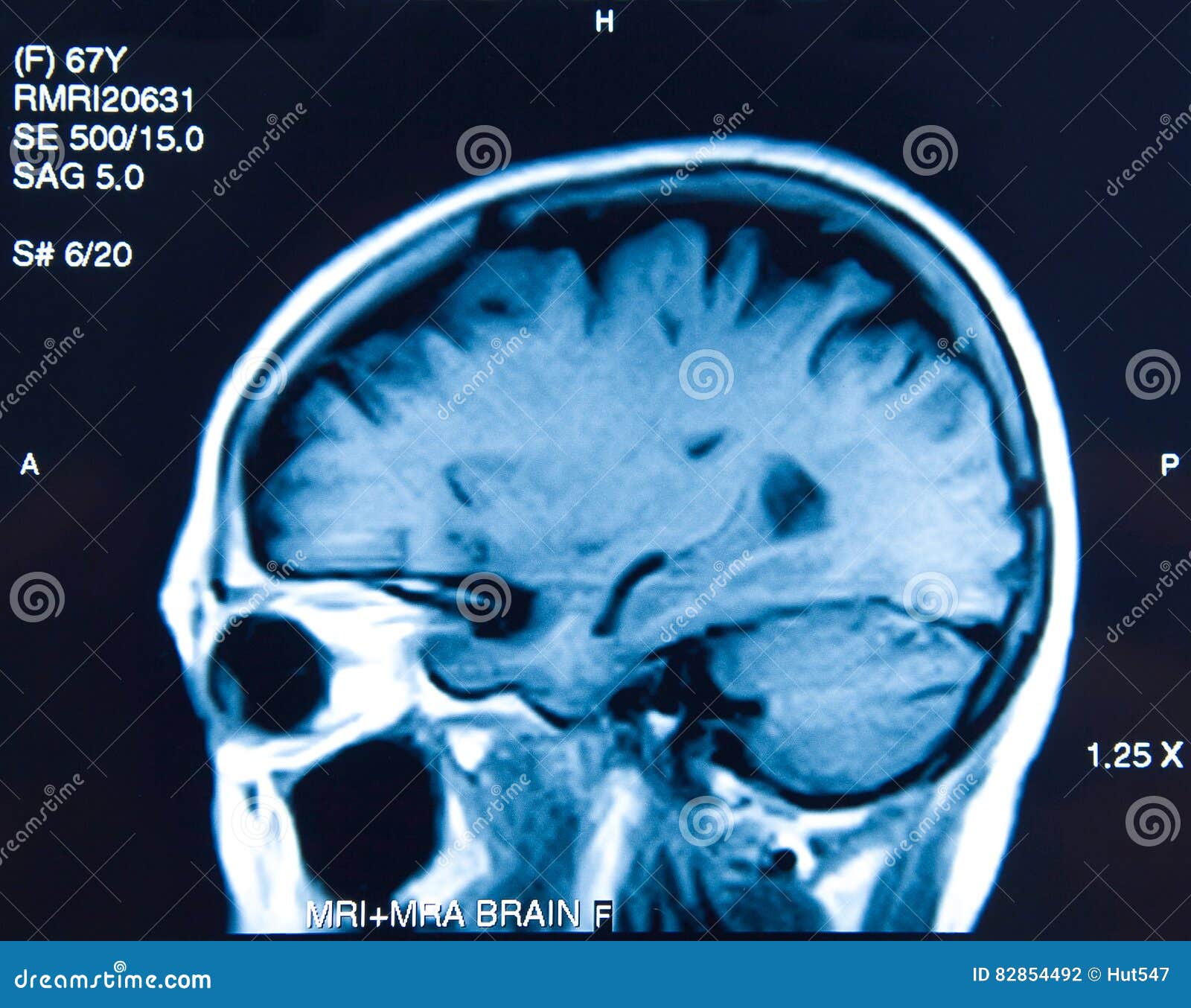 Closeup of a CT Scan Woman Brain. Stock Photo - Image of organ, blue ...