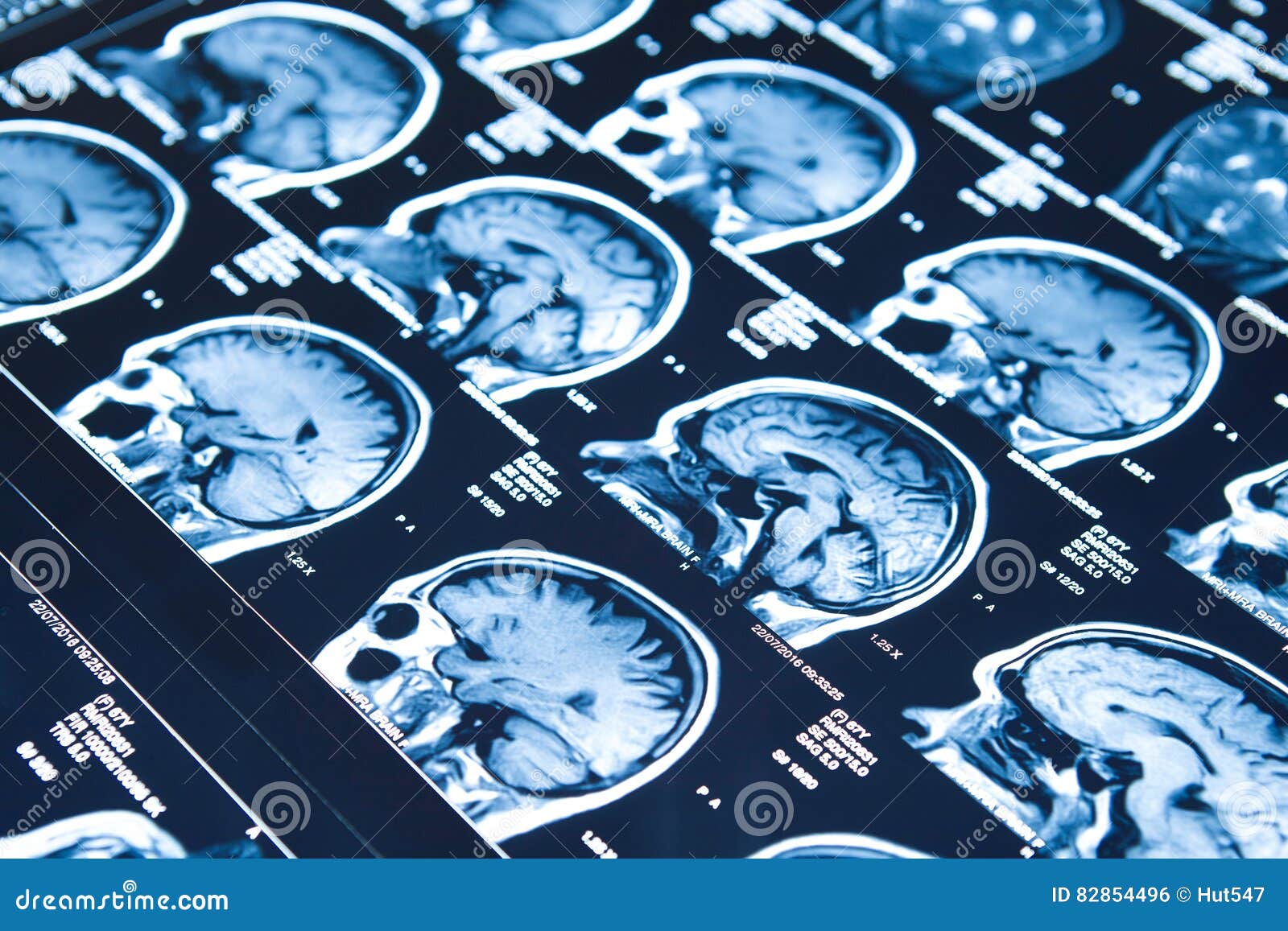 Closeup of a CT Scan Woman Brain. Stock Photo - Image of background ...