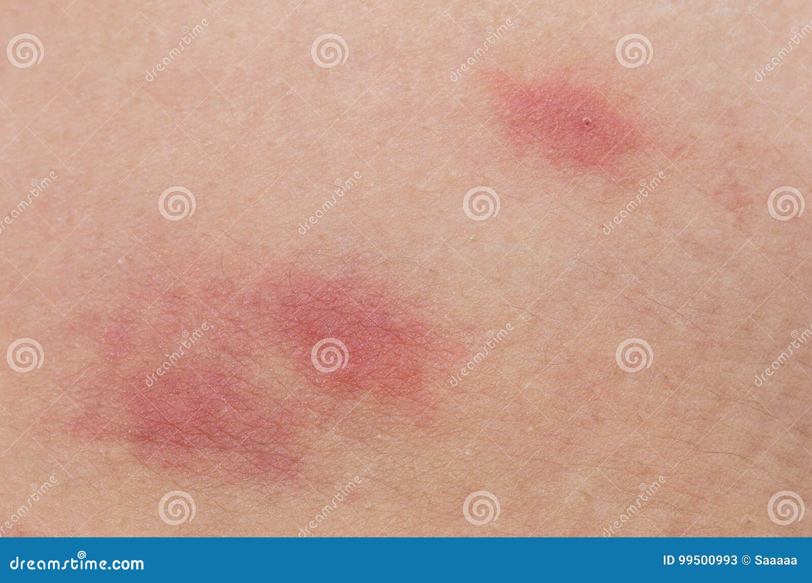 Closeup of flea bites stock image. Image of itchy, white - 99500993