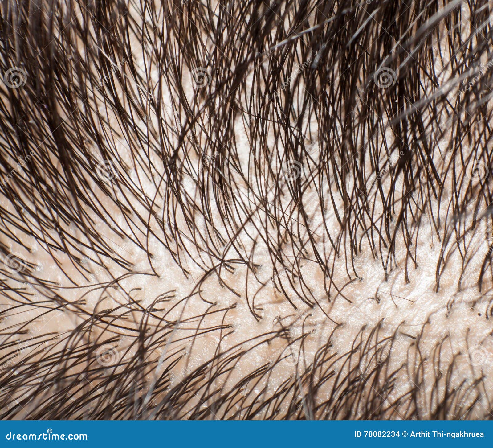 Closeup Head with Hair and Scalp Stock Photo - Image of male, problem ...