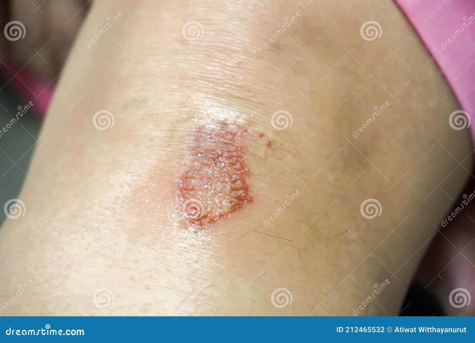 Closeup Human Nee Abrasions from Fall Accident Stock Photo - Image of ...