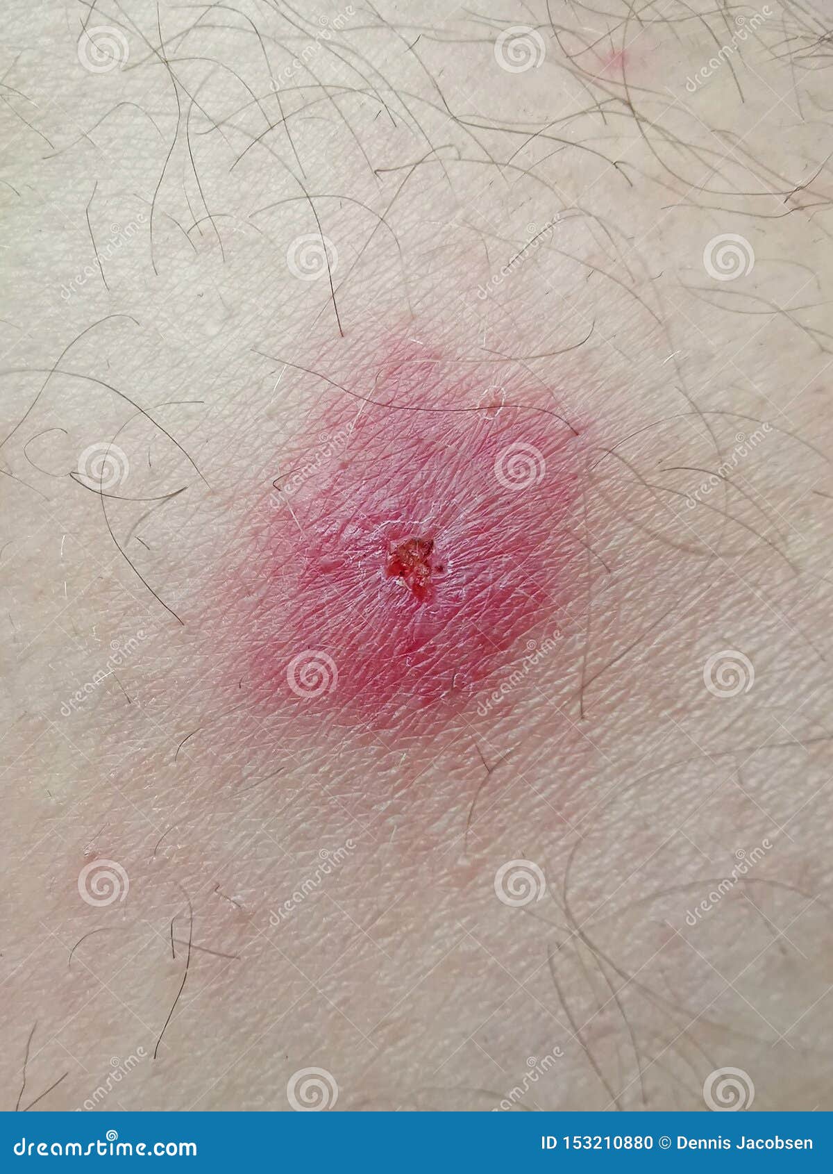 Closeup of a bug bite stock photo. Image of insect, closeup - 153210880