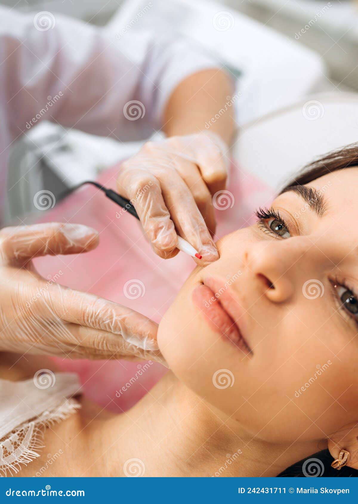 Closeup Image of Dermatologist& X27;s Hands Doing Electro-epilation ...