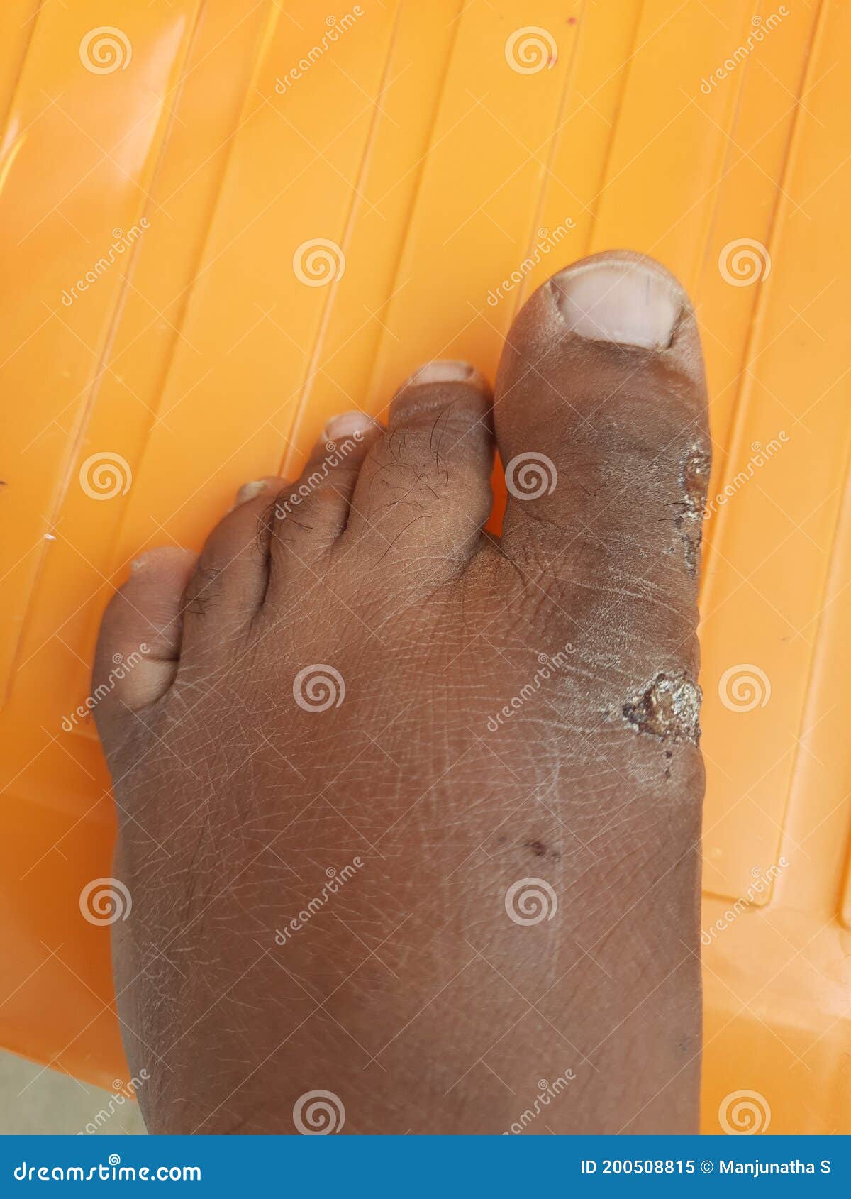 Indian Man Wound on Leg or Feet Stock Image - Image of blood, human ...