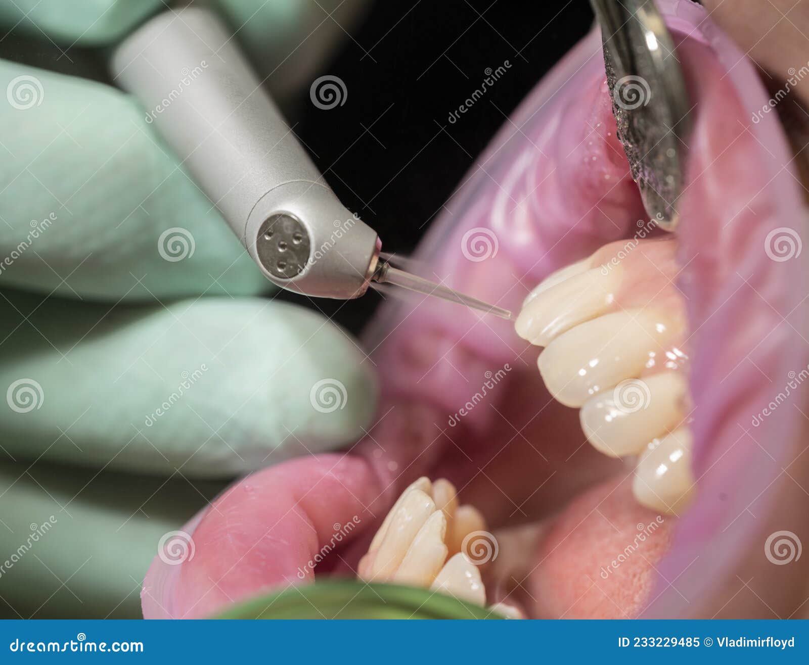 Closeup of Laser Etching Teeth Procedure Stock Image - Image of closeup ...