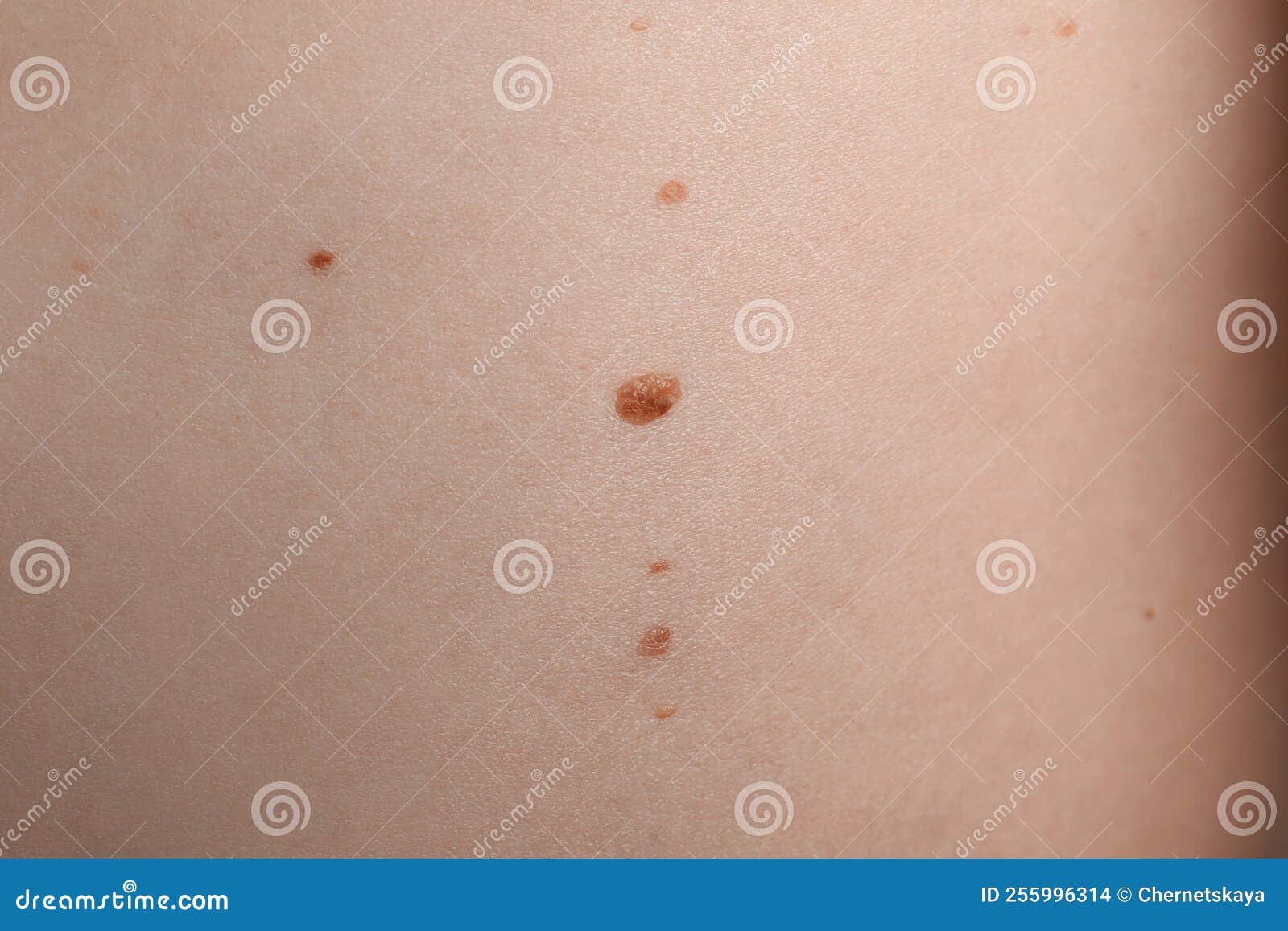 Closeup of Man`s Body with Birthmarks As Background Stock Photo - Image ...