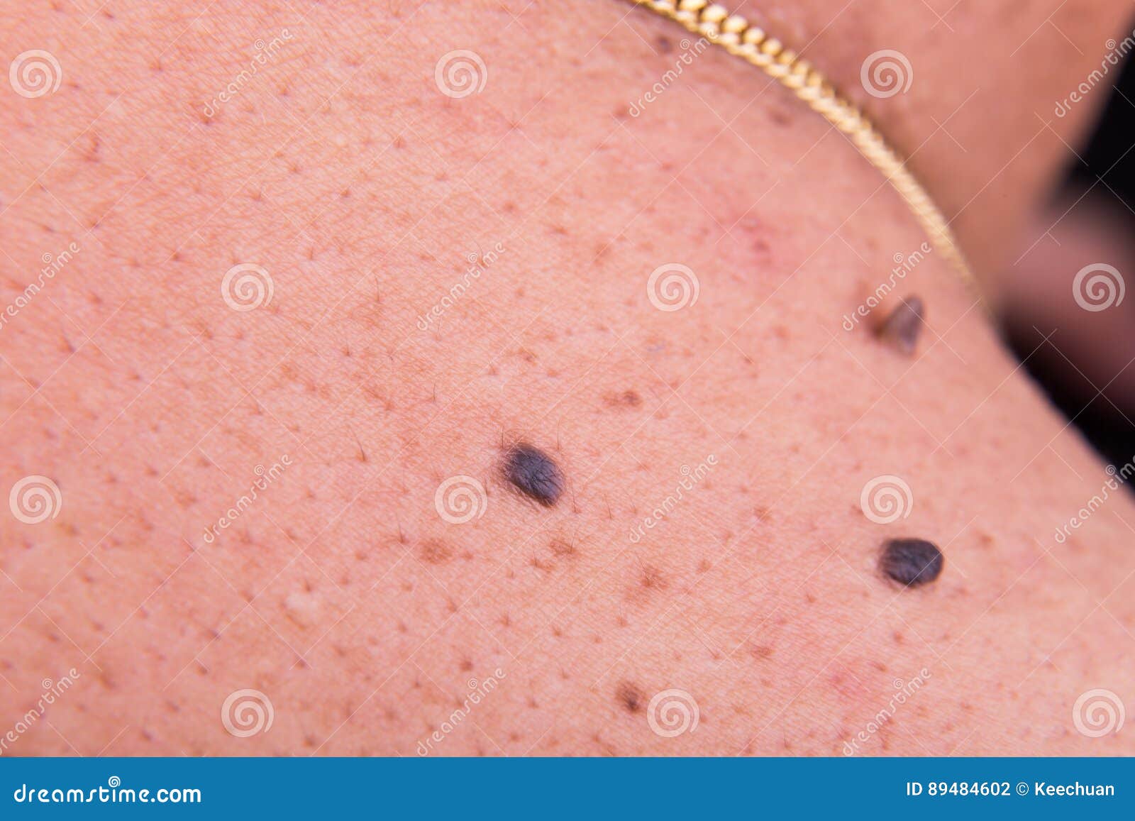 Closeup of Multiple Moles on Shoulder of Asian Man Stock Photo - Image ...