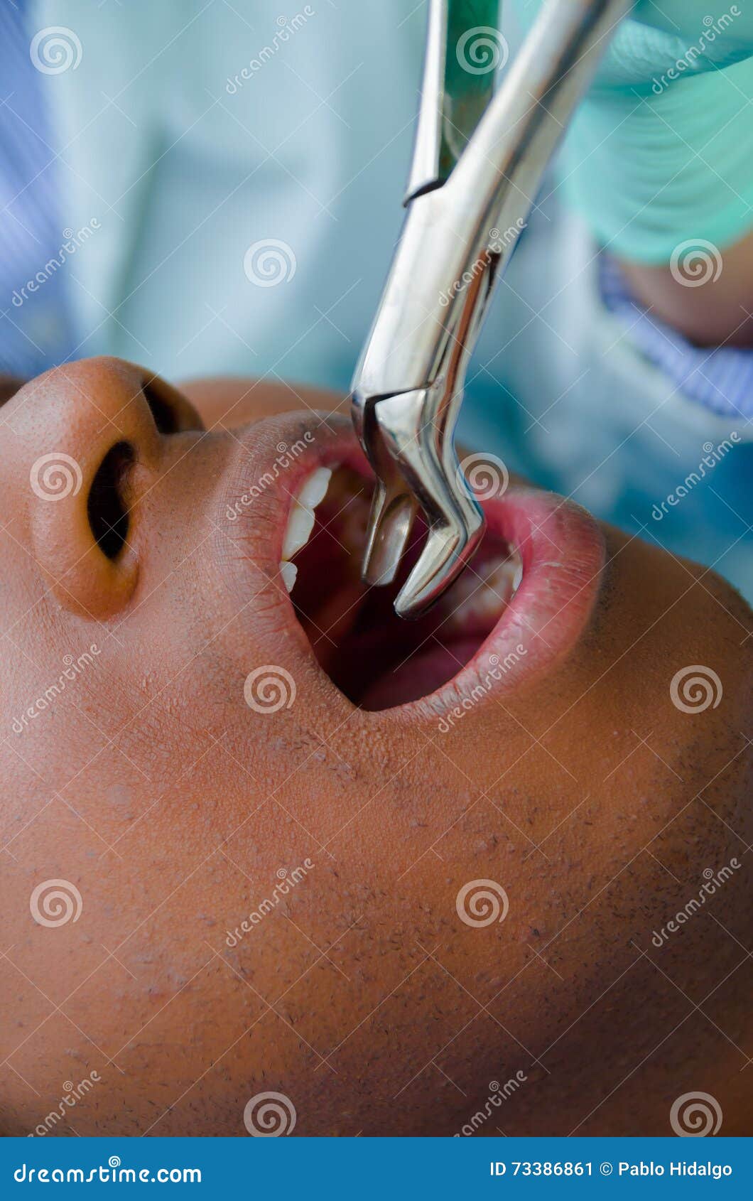 Closeup Open Mouth with Dental Tools Inside, Hispanic Male Patient ...