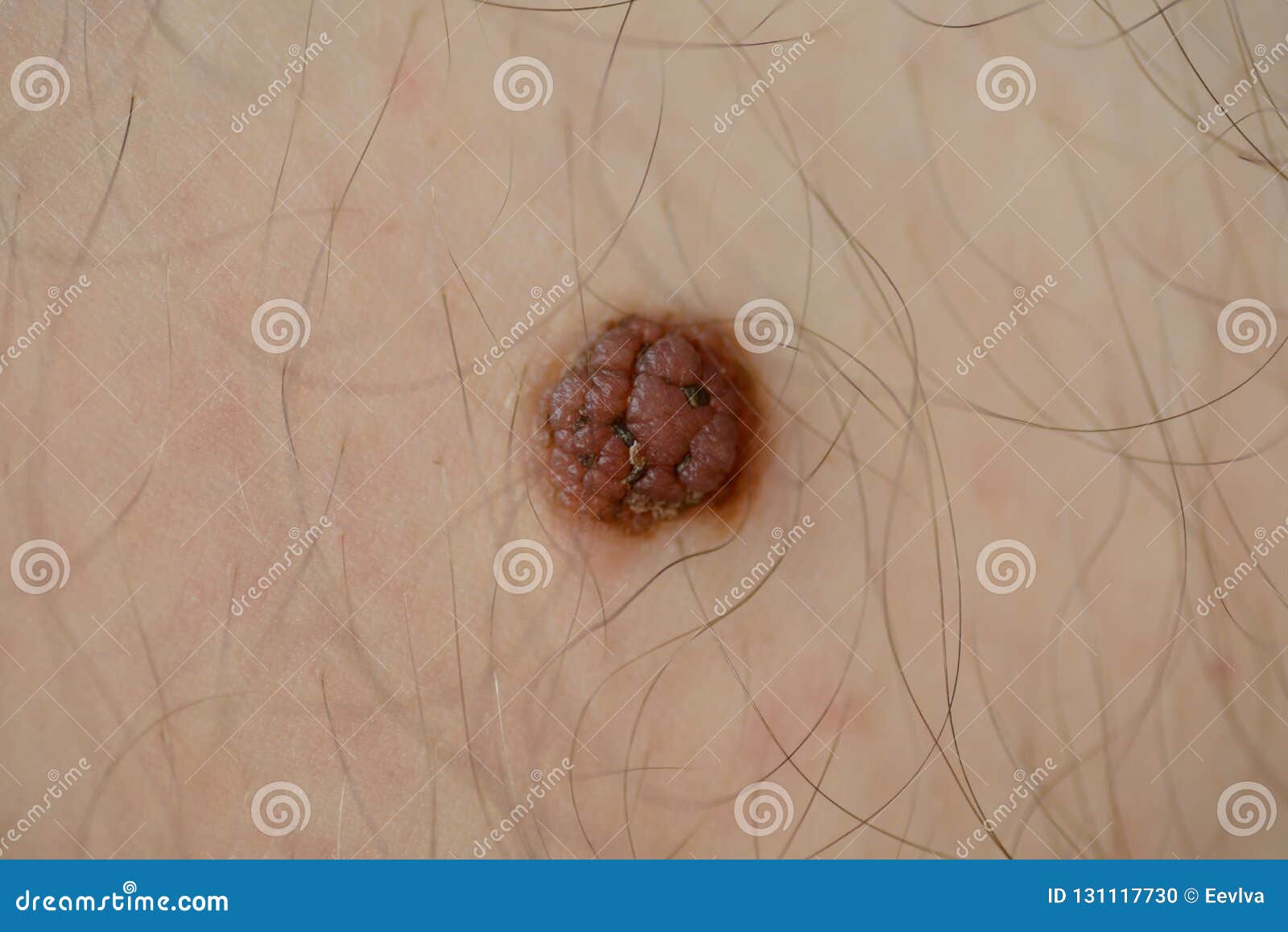 Closeup photo of nevus. stock photo. Image of melanoma - 131117730