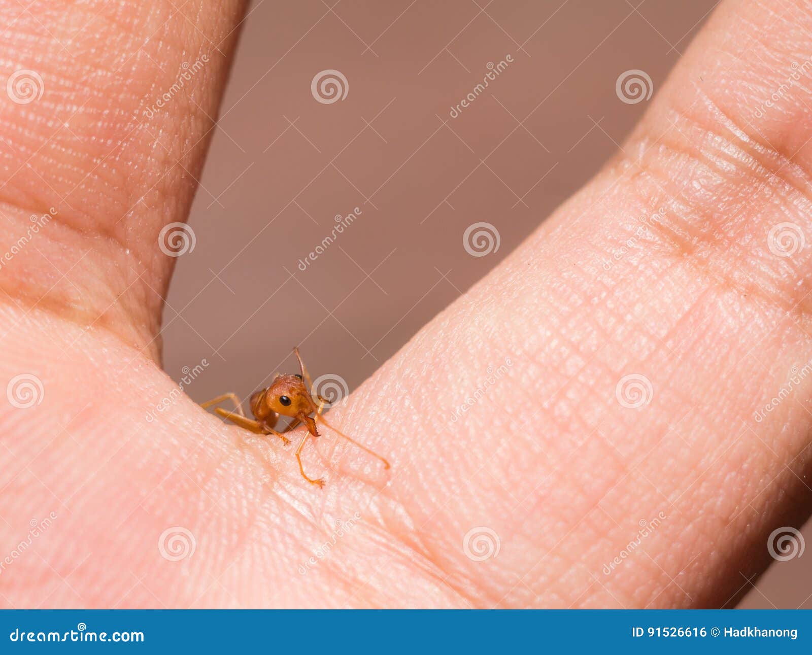 Closeup Red Ant Bite Man Hand Stock Photo - Image of bite, white: 91526616