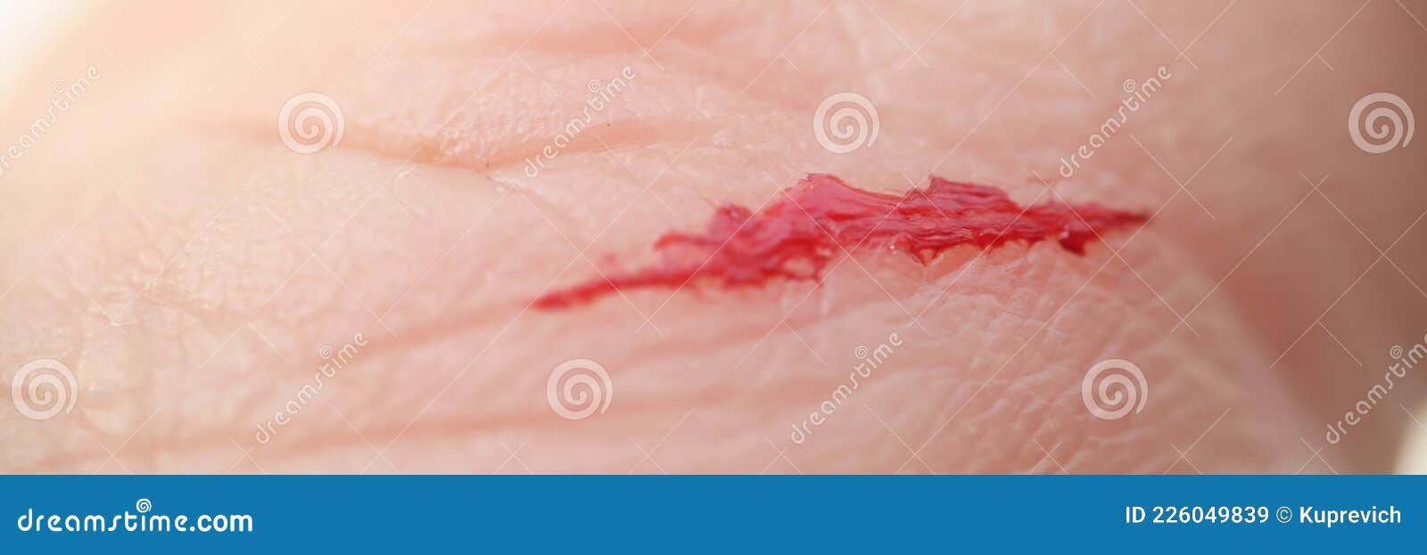 Closeup of Scratch with Blood on Man Hand Stock Image - Image of ...