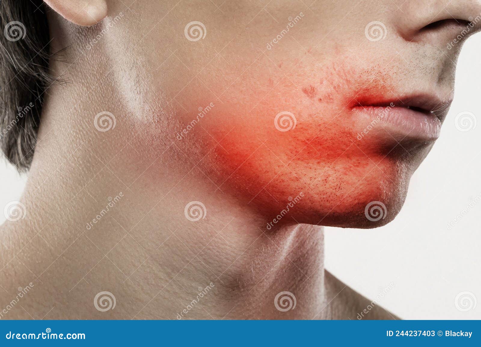 Sensitive Skin Irritation after a Shaving Routine Stock Image - Image ...