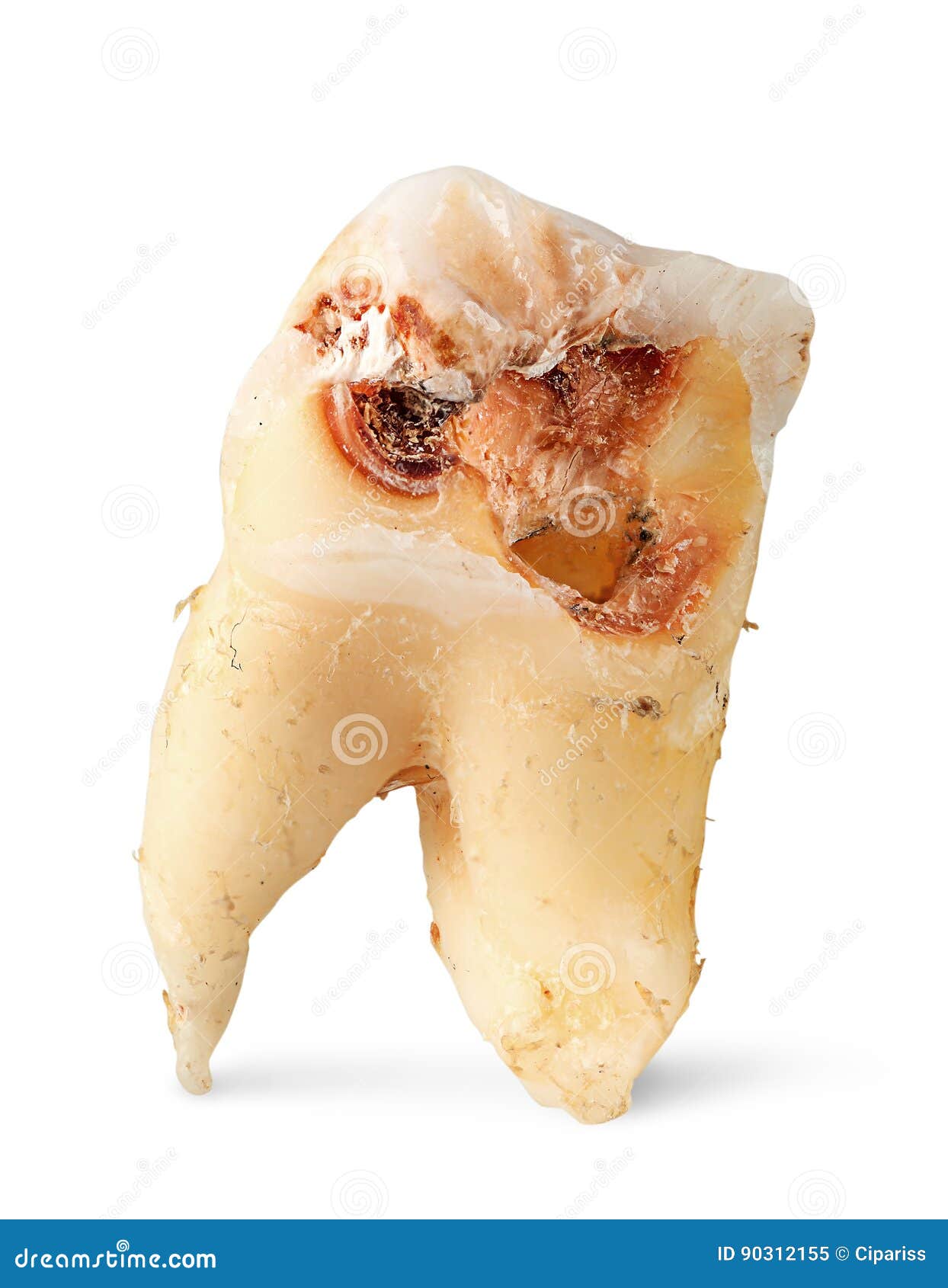 Closeup Single Tooth with Caries Vertically Stock Image - Image of ...