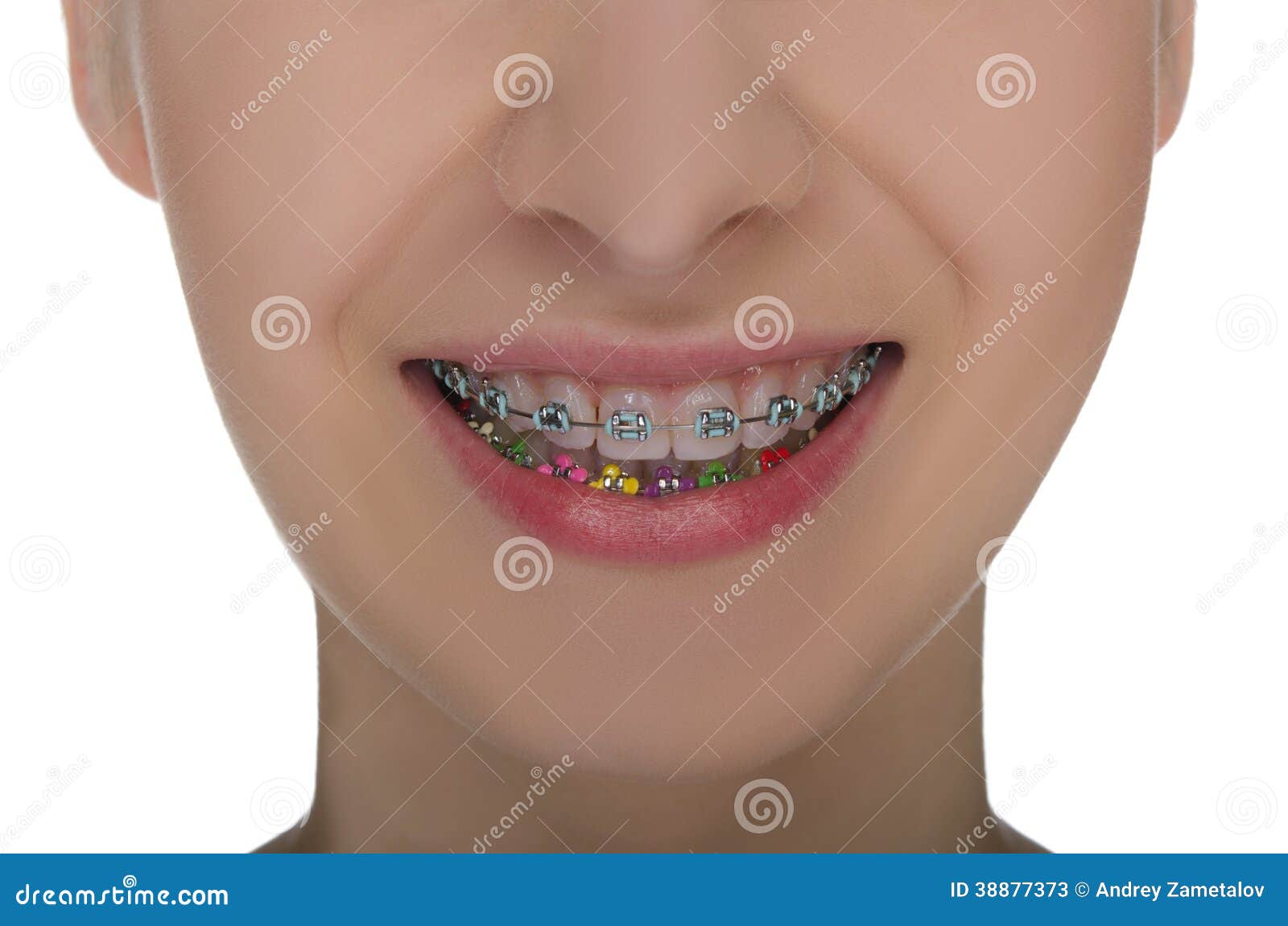 Closeup of Smiling Mouth with Braces on Teeth Stock Image - Image of ...