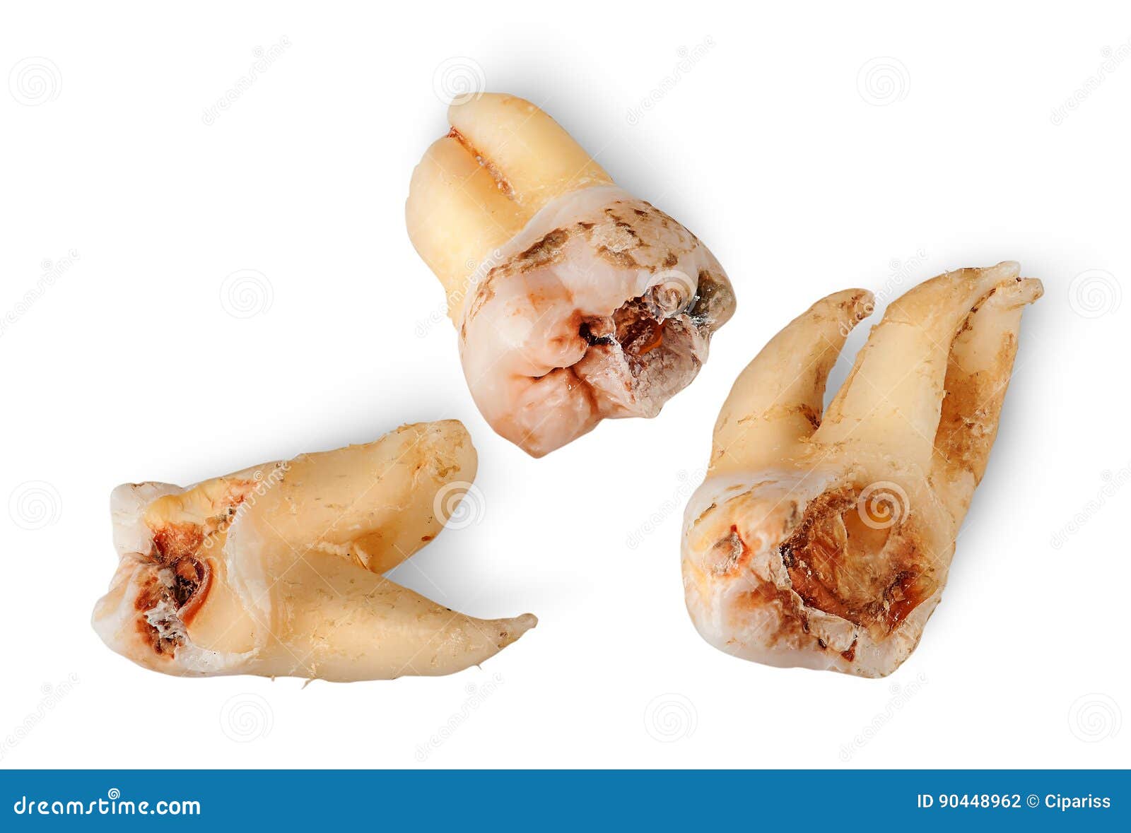 Closeup Three Teeth with Caries Stock Photo - Image of dentistry ...
