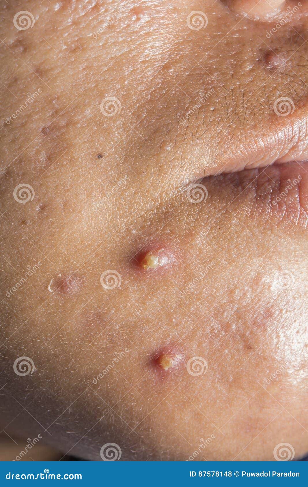 Closeup for Two Acne on Chin Stock Photo - Image of young, acne: 87578148