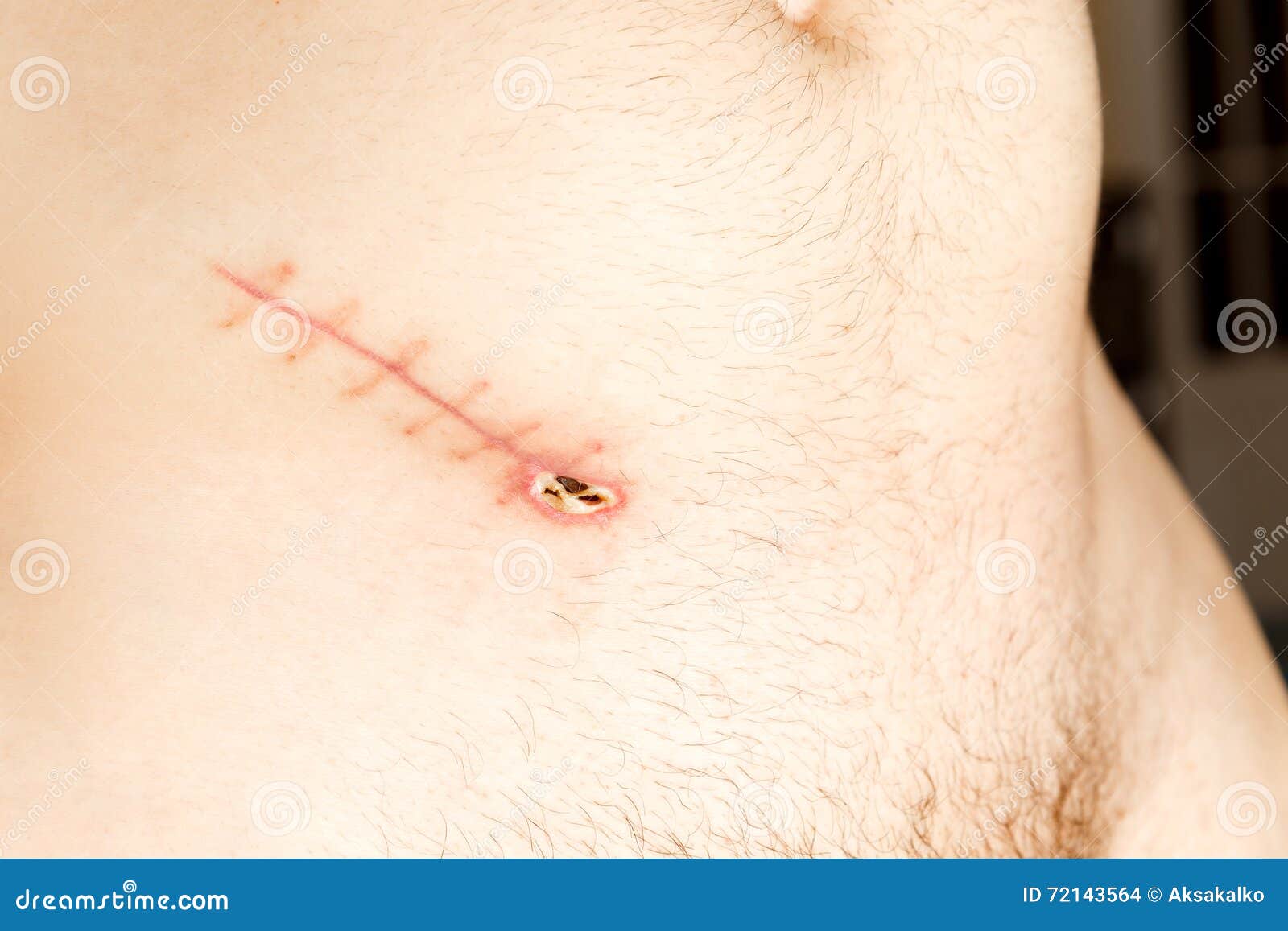 Closeup of Unhealed Appendix Surgery Scar Stock Photo - Image of ...