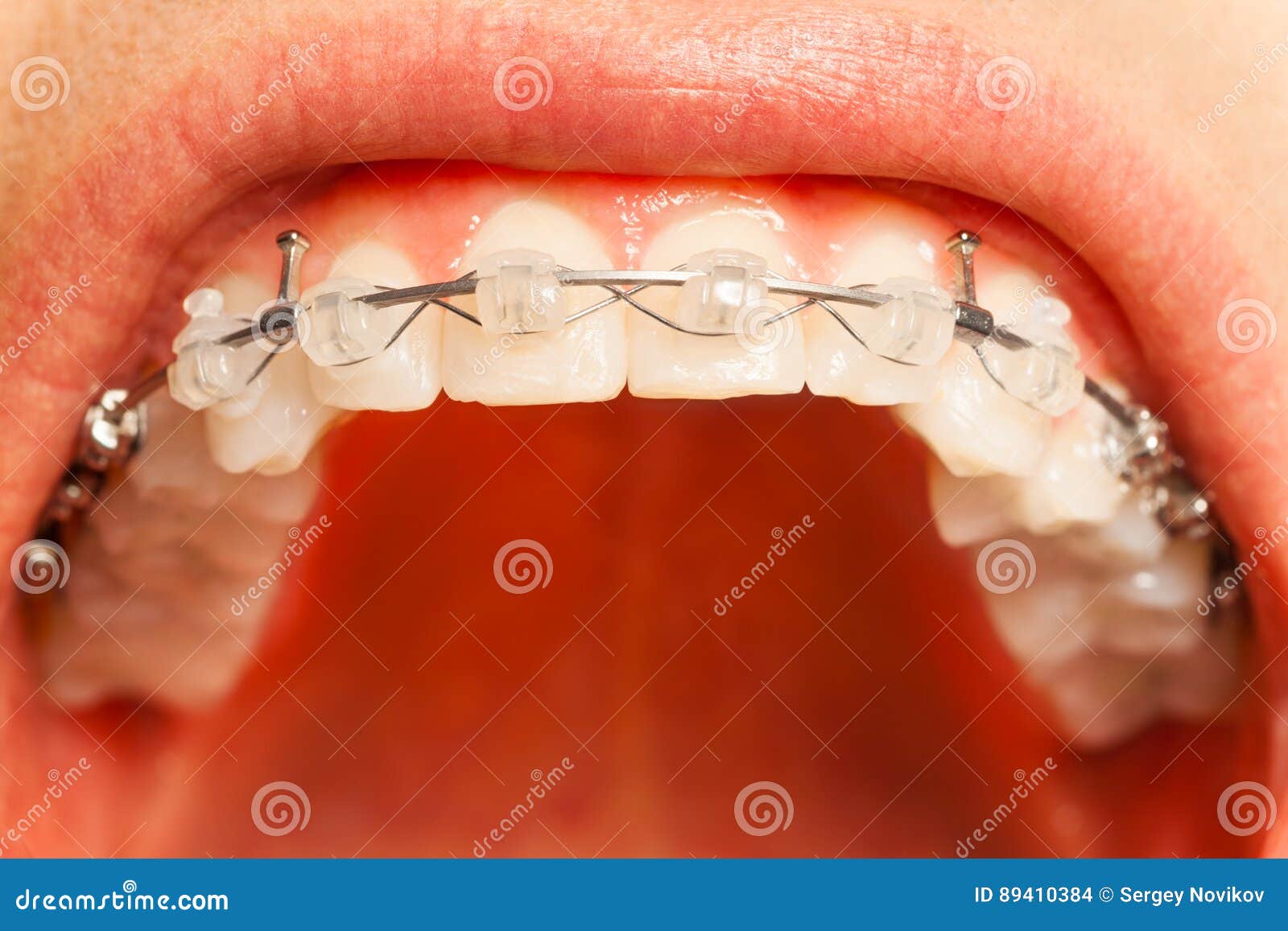 Closeup Upper Jaw of a Man with Braces on Teeth Stock Photo - Image of ...