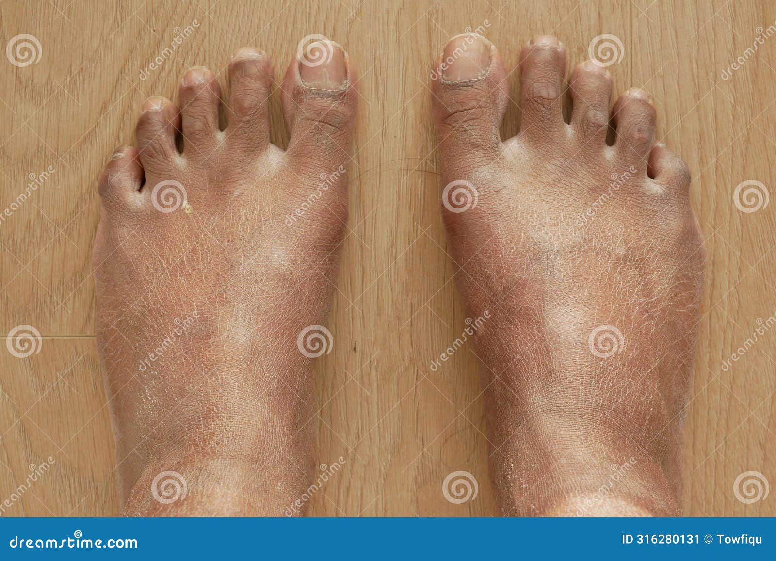 Closeup View of Dry Human Feet Skin . Stock Image - Image of ...