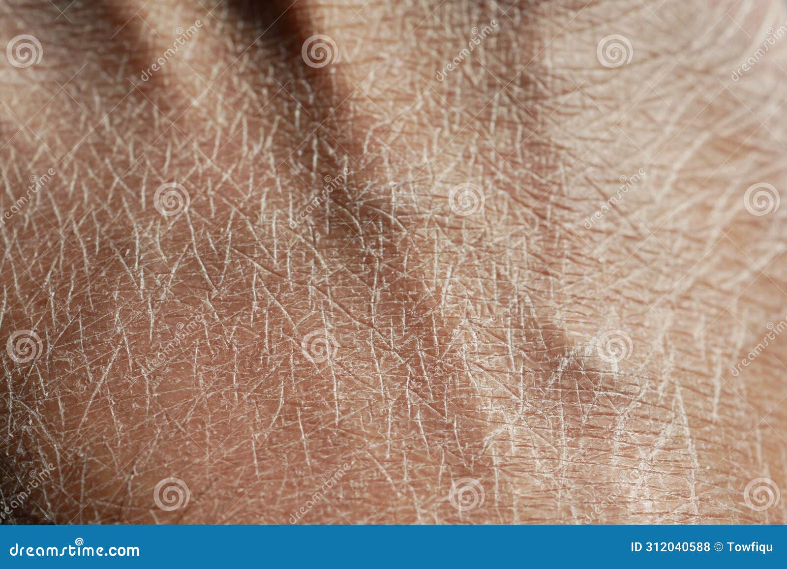 Closeup View of Dry Human Skin . Stock Photo - Image of medicine ...