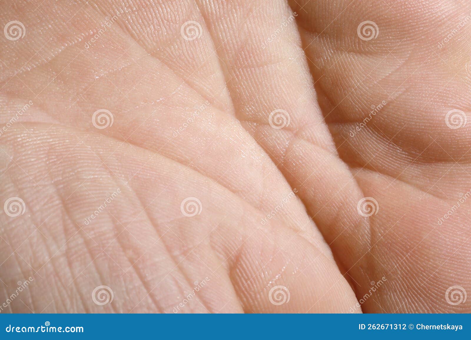 Closeup View of Human Hand with Dry Skin Stock Photo - Image of healthy ...