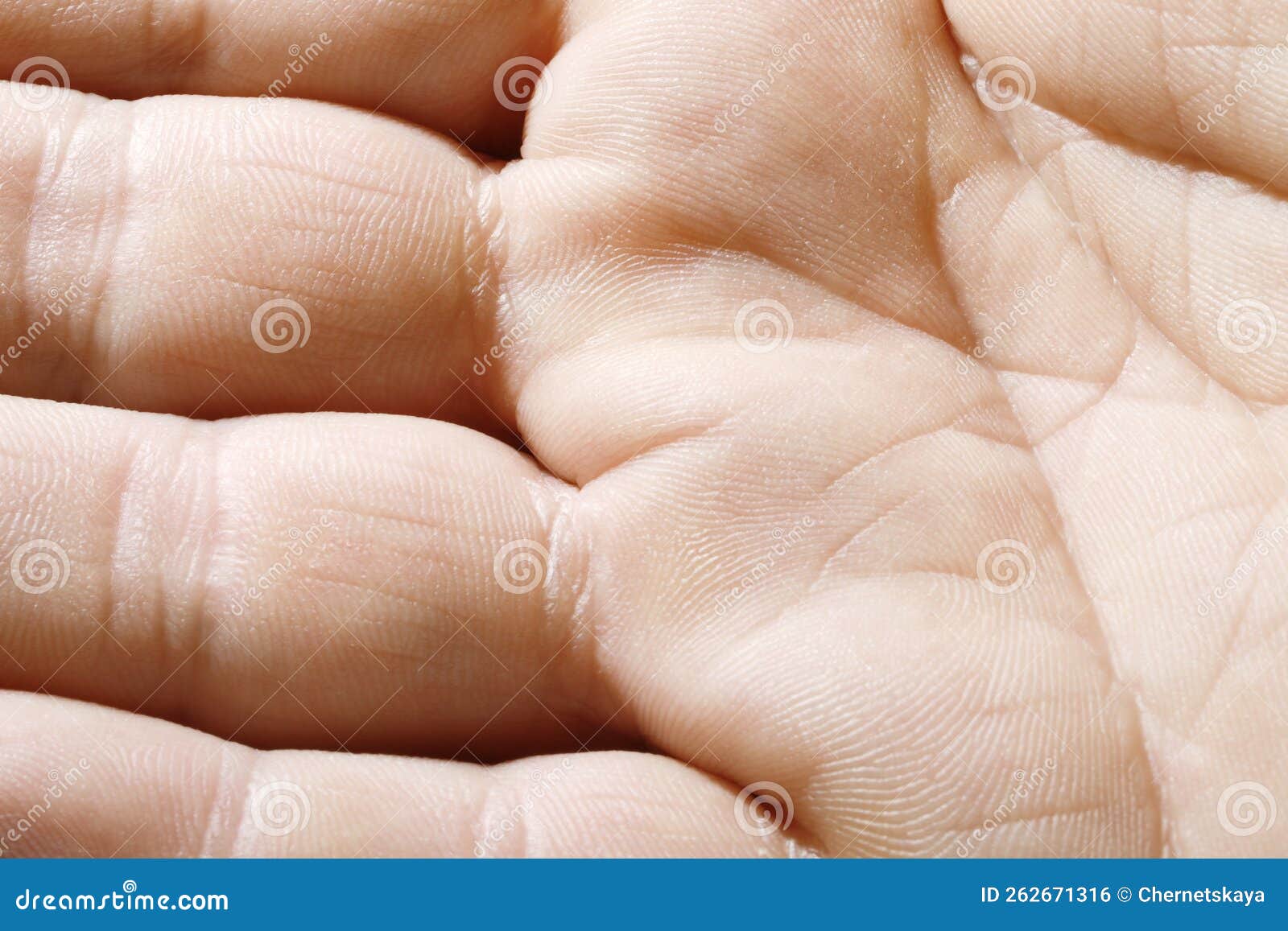 Closeup View of Human Hand with Dry Skin Stock Photo - Image of disease ...