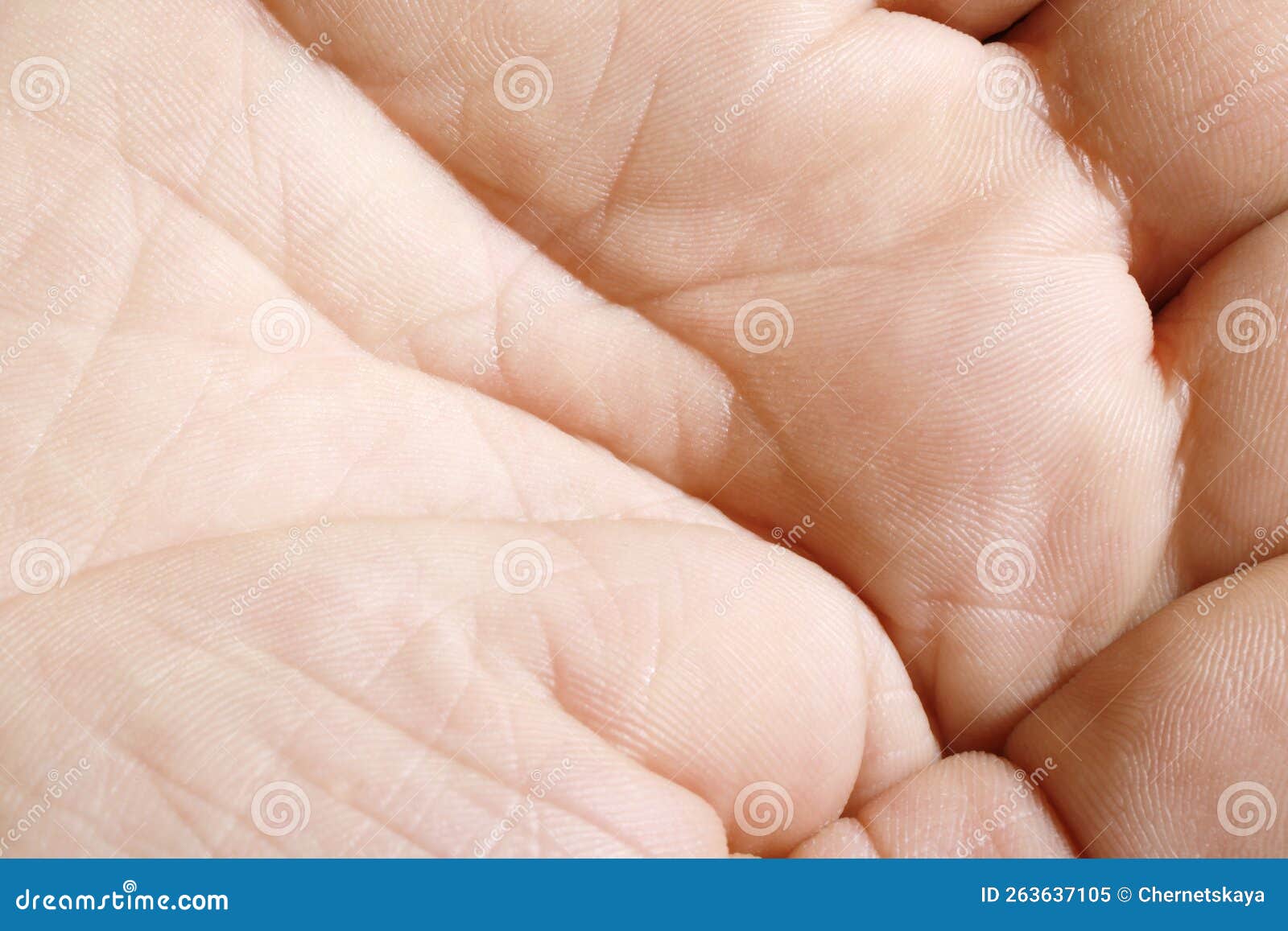Closeup View of Human Hand with Dry Skin Stock Image - Image of normal ...