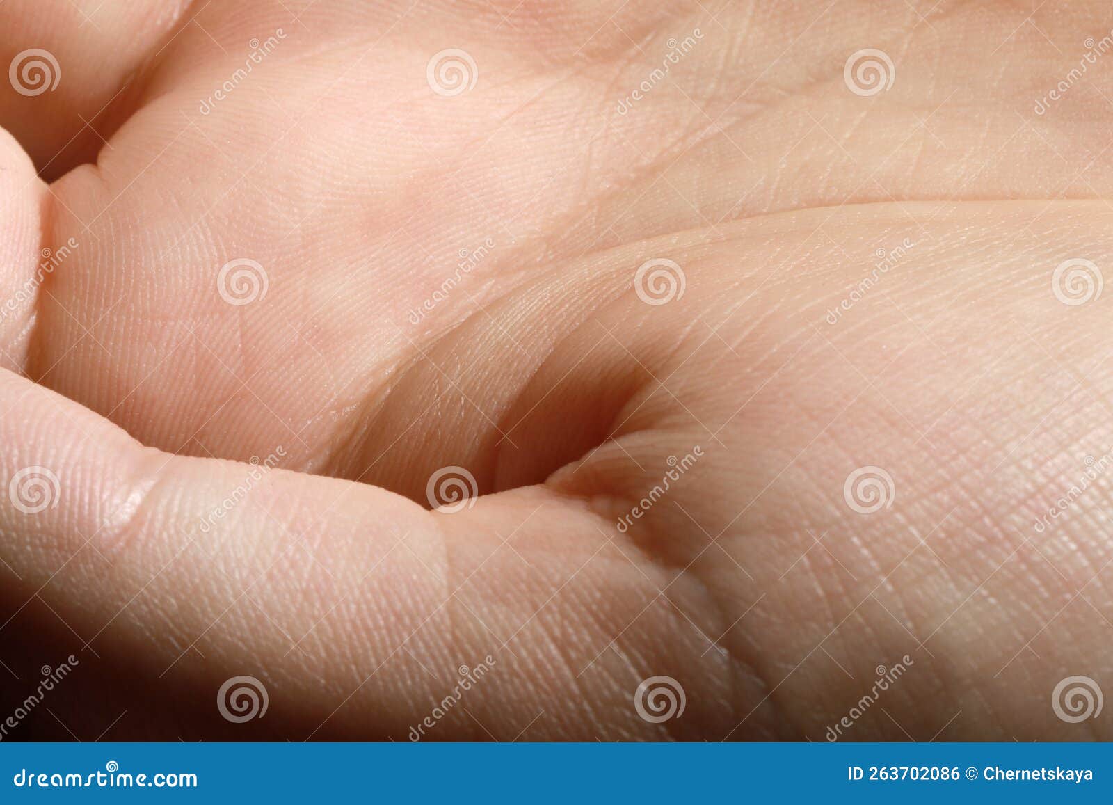 Closeup View of Human Hand with Dry Skin Stock Photo - Image of dryness ...