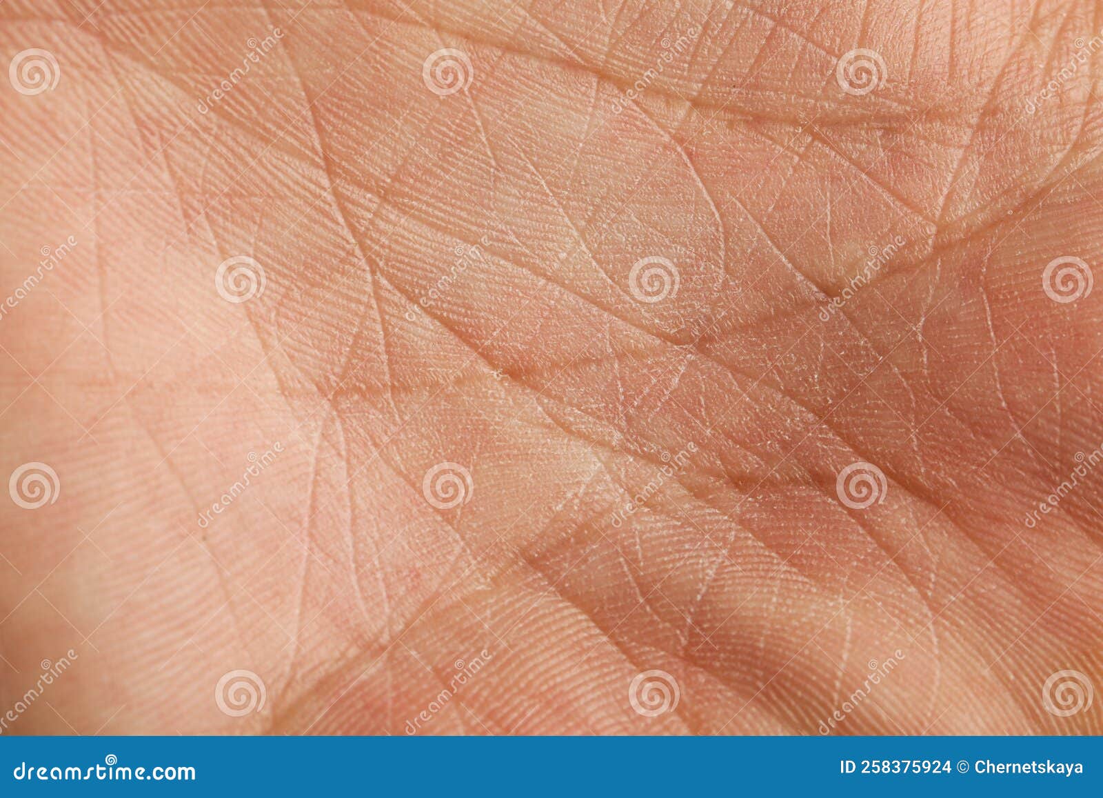 Closeup View of Human Palm with Dry Skin Stock Photo - Image of ...