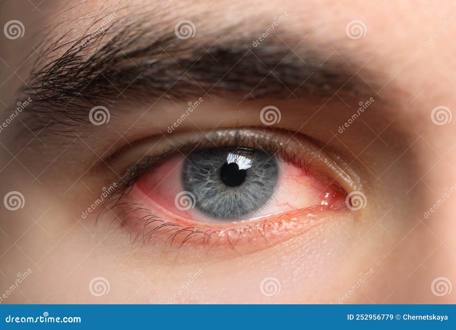 Closeup View of Man with Inflamed Eyes Stock Image - Image of illness ...