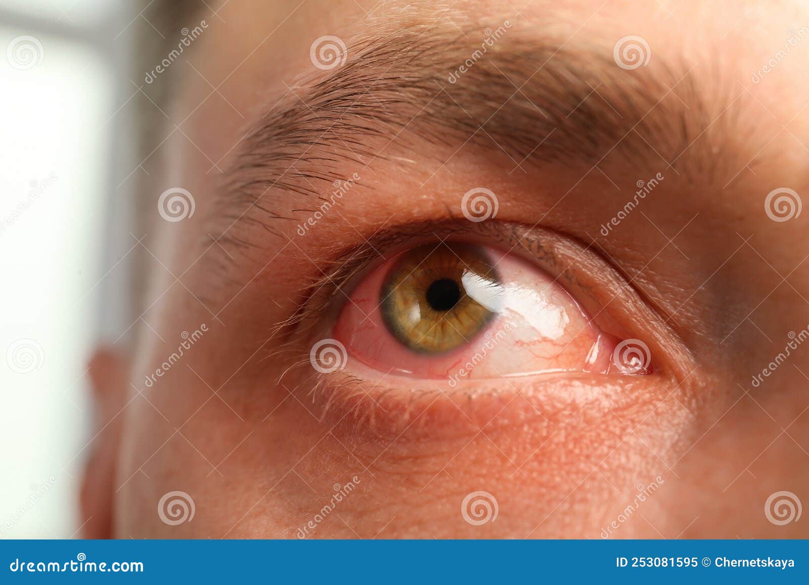 Closeup View of Man with Inflamed Eyes Stock Image - Image of patient ...