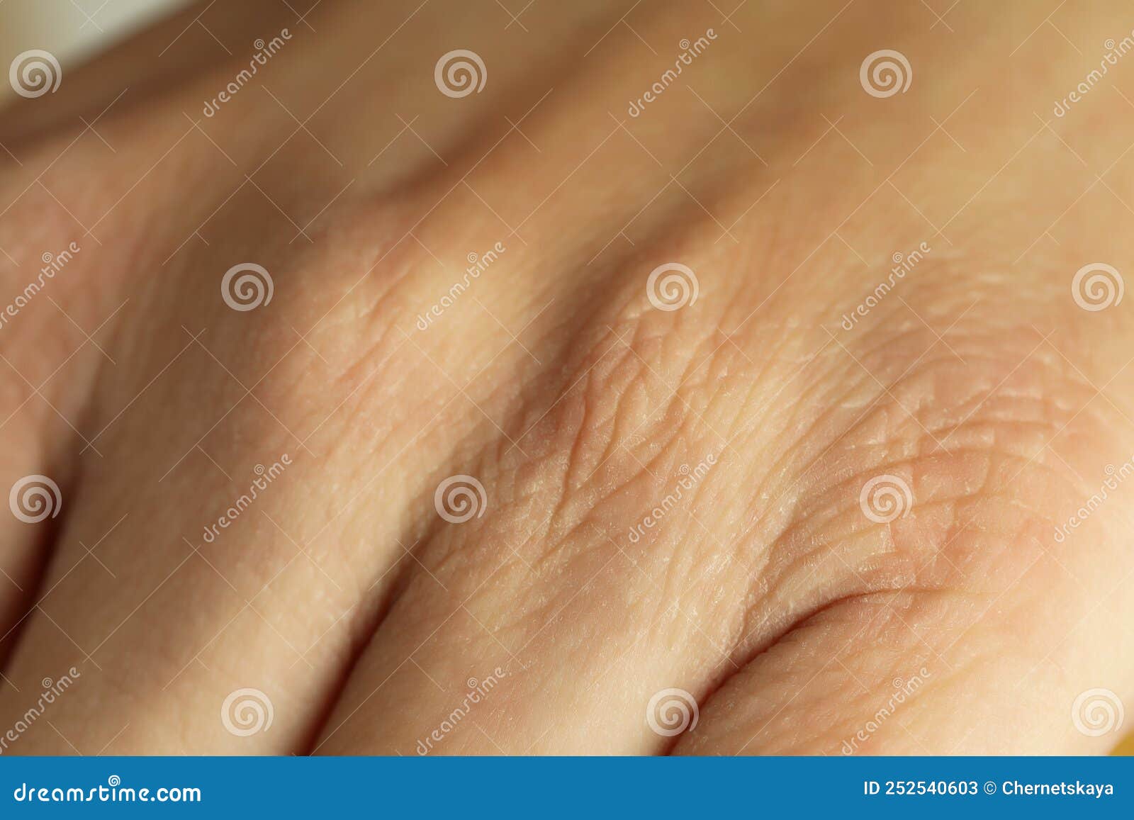 Closeup View of Person with Dry Skin on Hand Stock Image - Image of ...