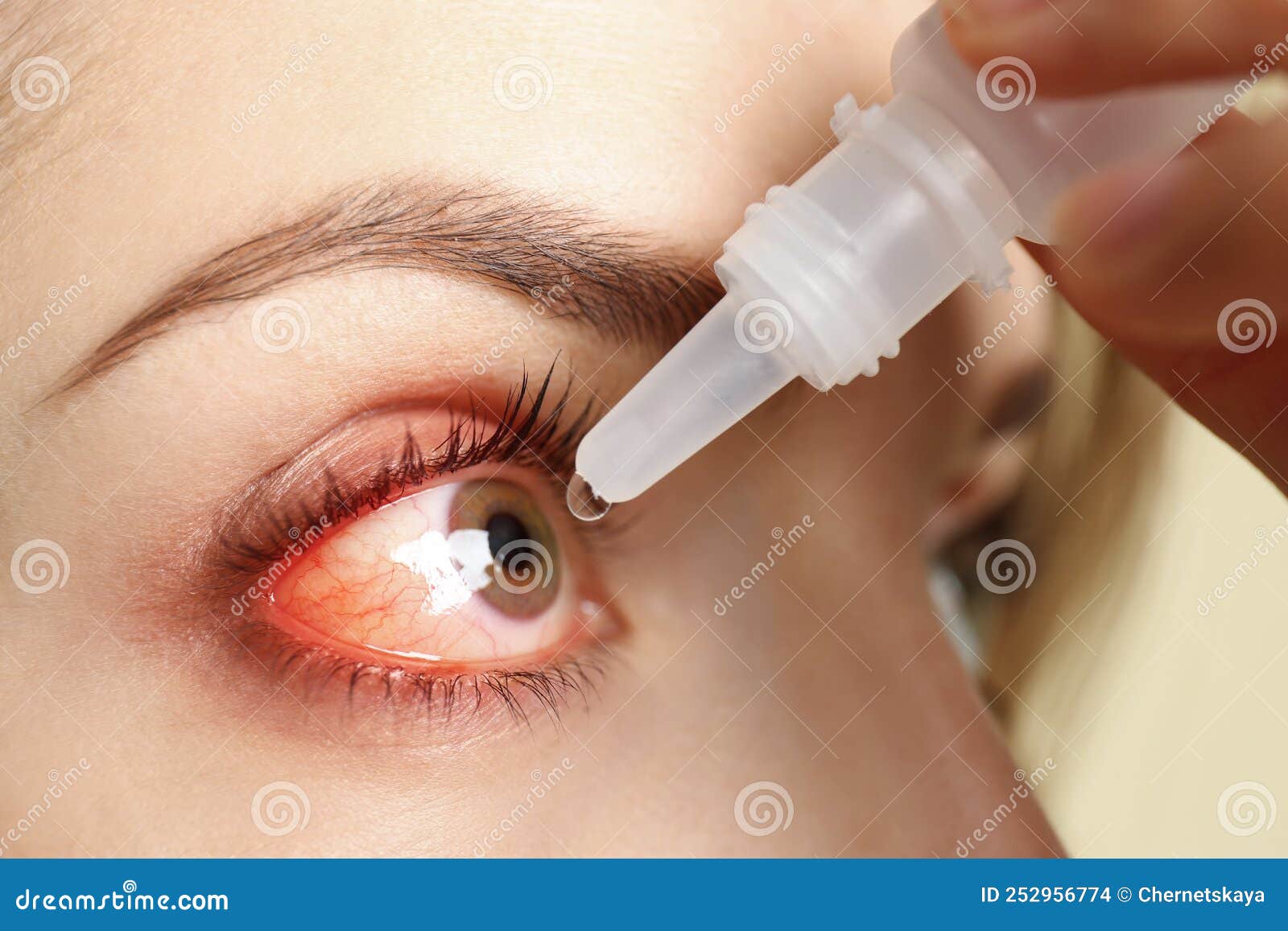 Closeup View of Woman with Inflamed Eyes Using Drops Stock Photo ...