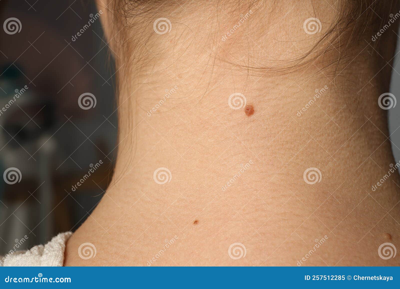 Closeup View of Woman`s Neck with Birthmarks Stock Image - Image of ...