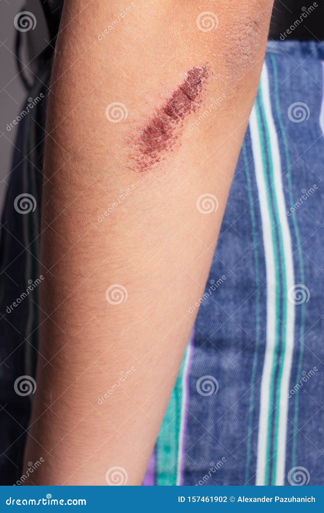 Closeup of a Woman`s Hand with an Elbow Wound. Stock Photo - Image of ...
