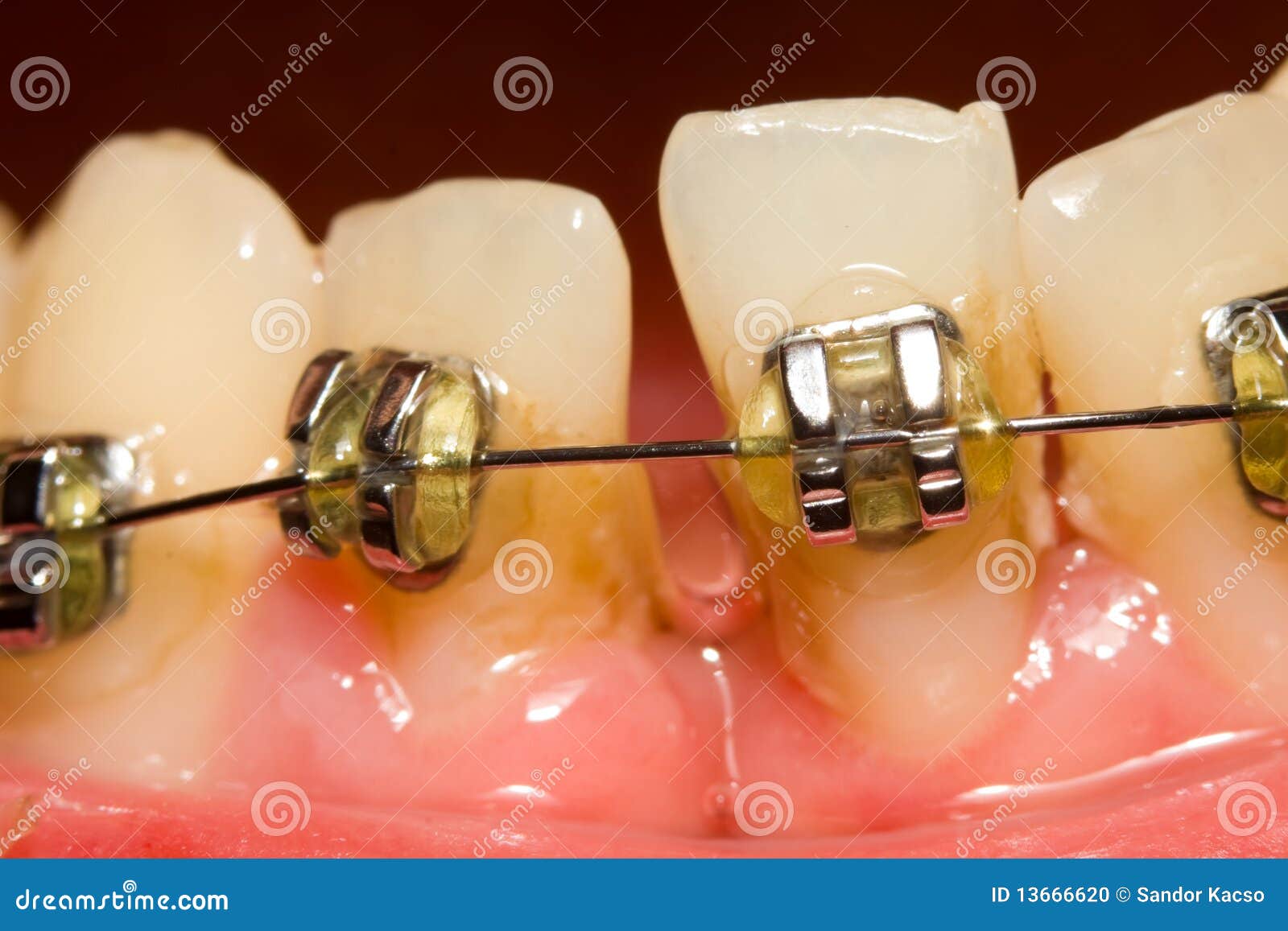 Closing of Gap with Dental Braces Stock Photo - Image of macro, dental ...