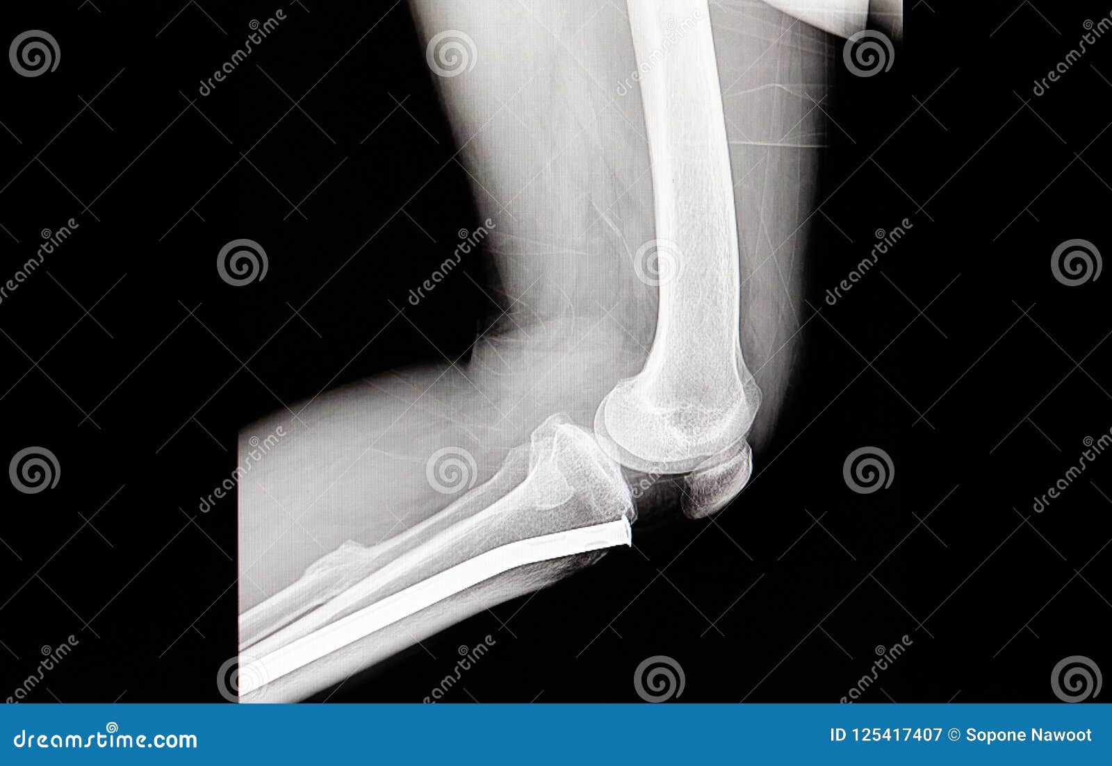 Clou Orthopédique Dans Le Tibia Image stock - Image du chirurgie ...