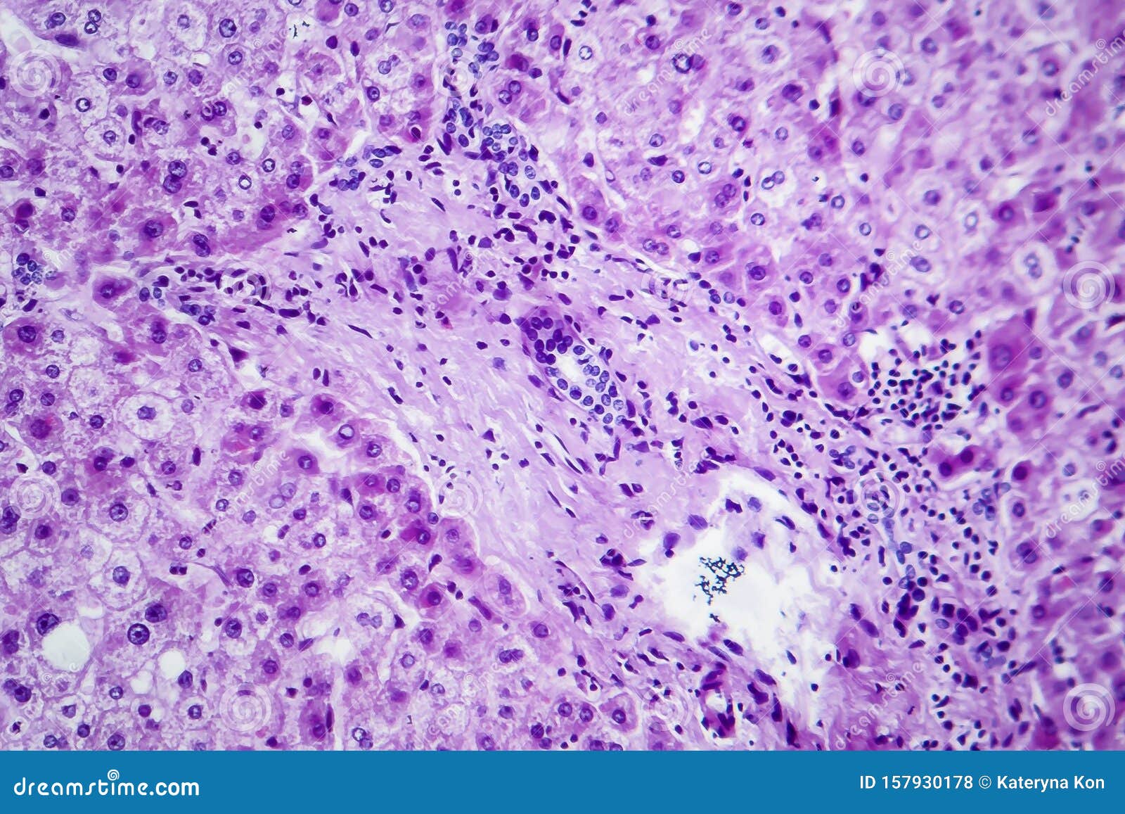 Cloudy Swelling of the Liver, Light Micrograph Stock Photo - Image of ...