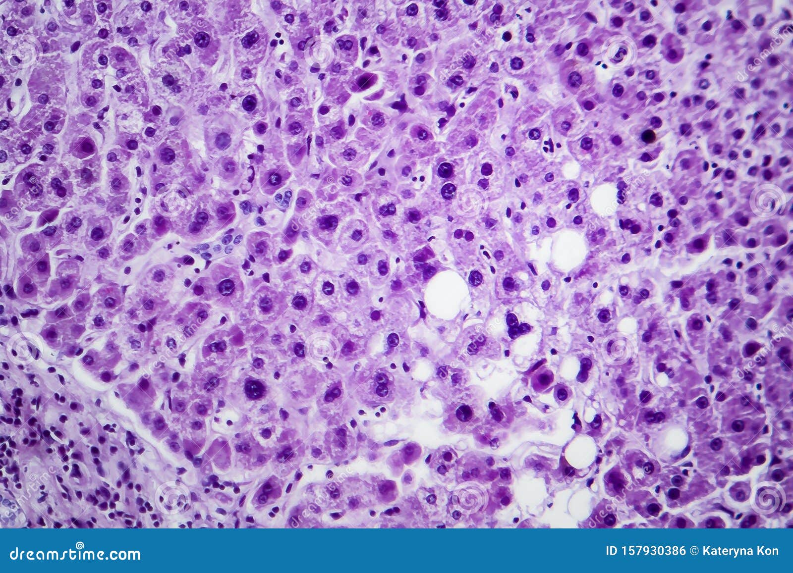 Cloudy Swelling of the Liver, Light Micrograph Stock Photo - Image of ...