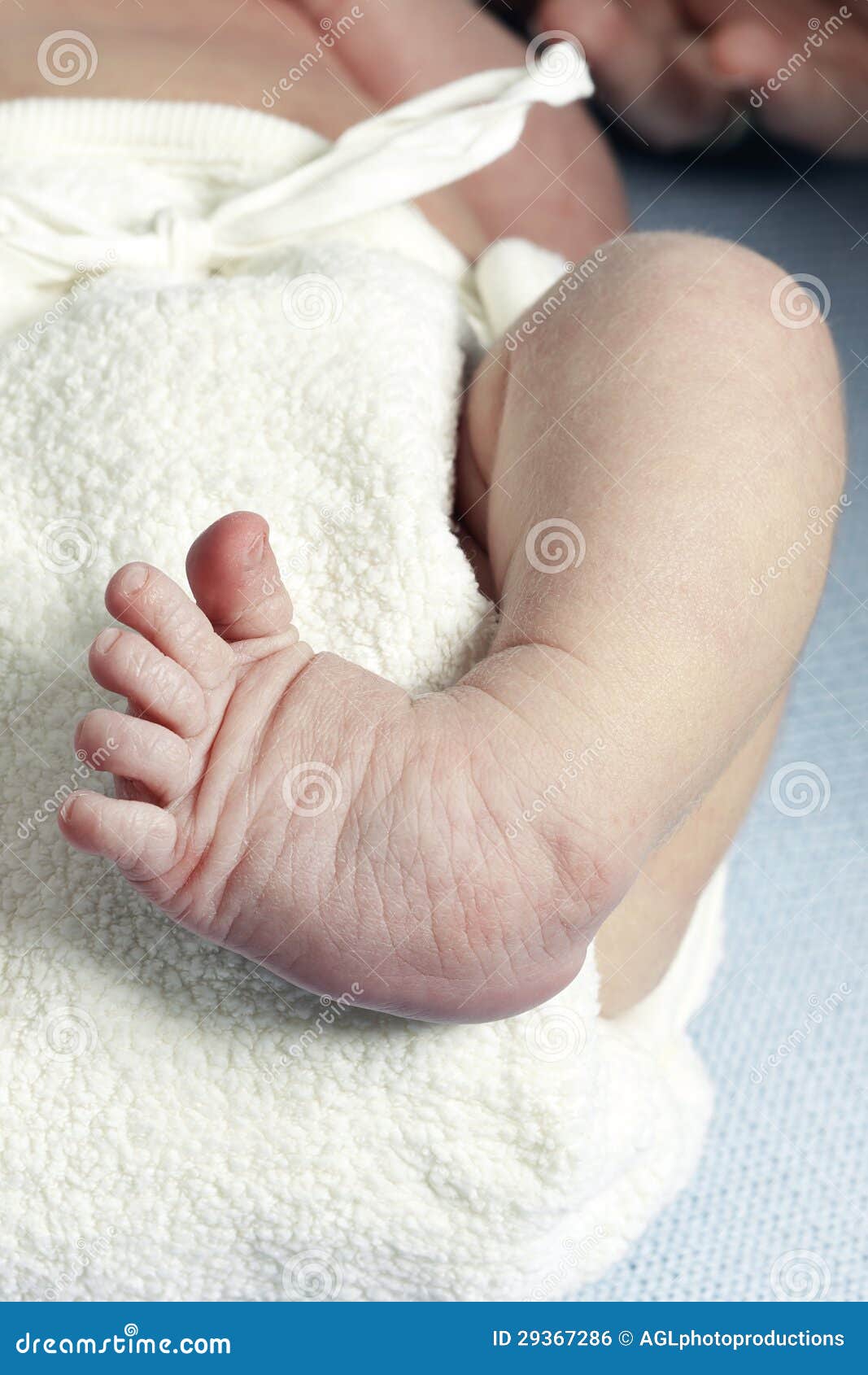 Bilateral Little Finger Deviation In Asian Young Man. Bilateral Hand ...