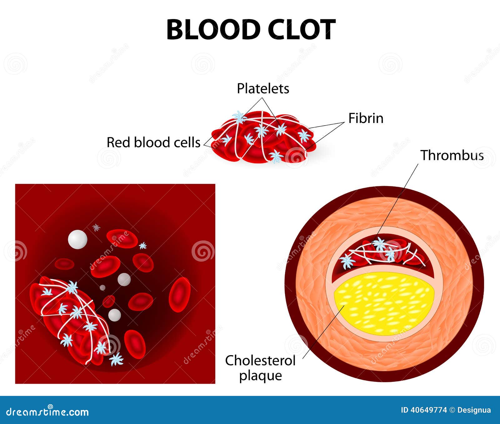 Coágulo De Sangre Diagrama Del Vector Ilustración del Vector ...