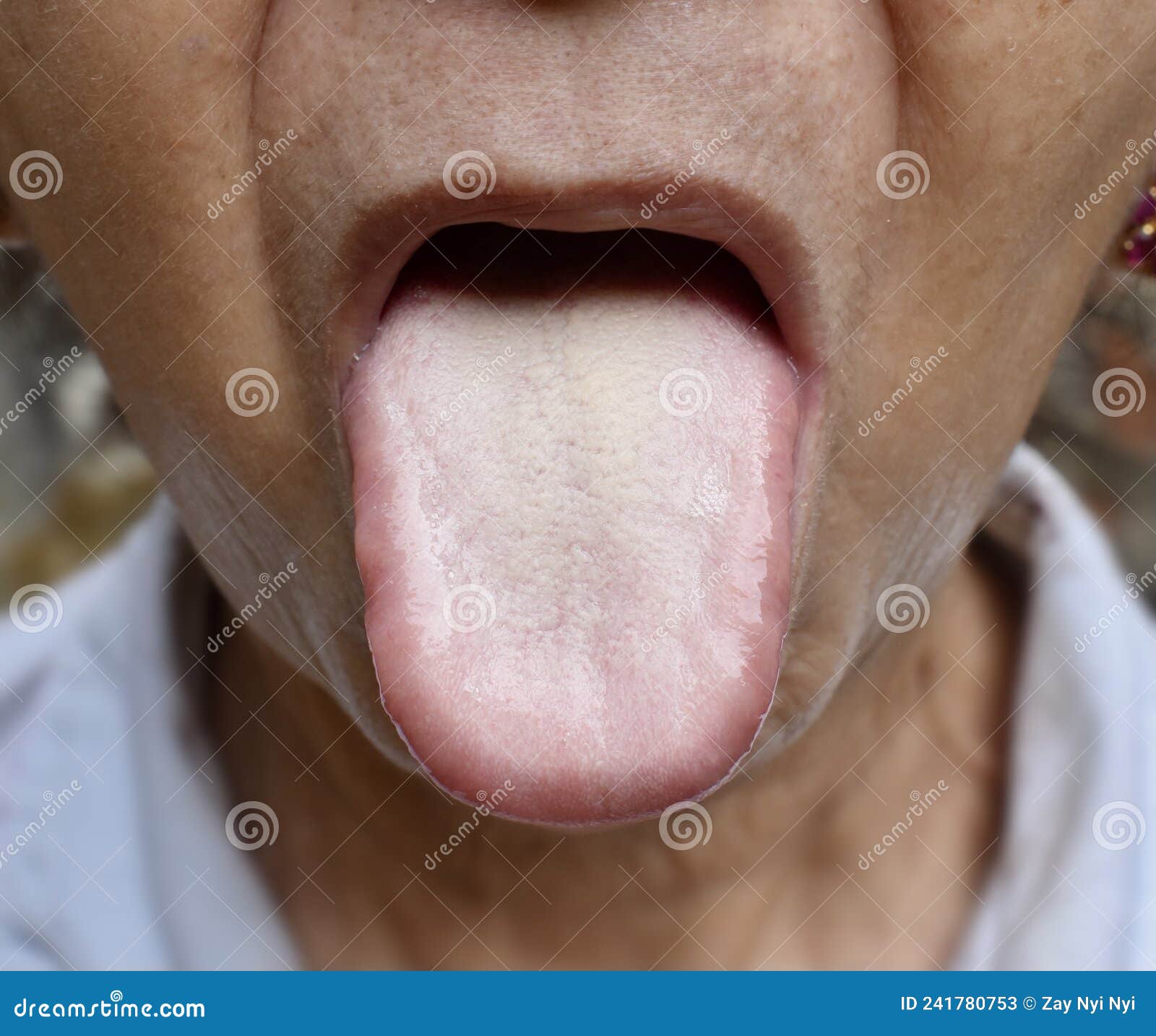 Enlarged Papillae